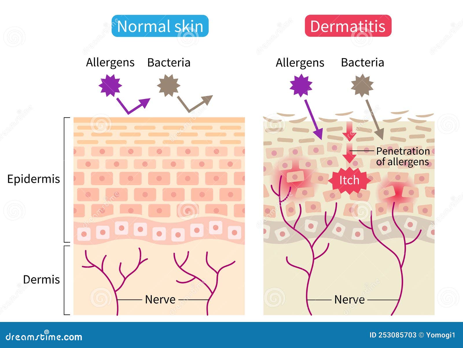 Atopic Dermatitis Eczema Cartoon Vector | CartoonDealer.com #120994175 Atopic Dermatitis Eczema Cartoon Vector | CartoonDealer.com #120994175