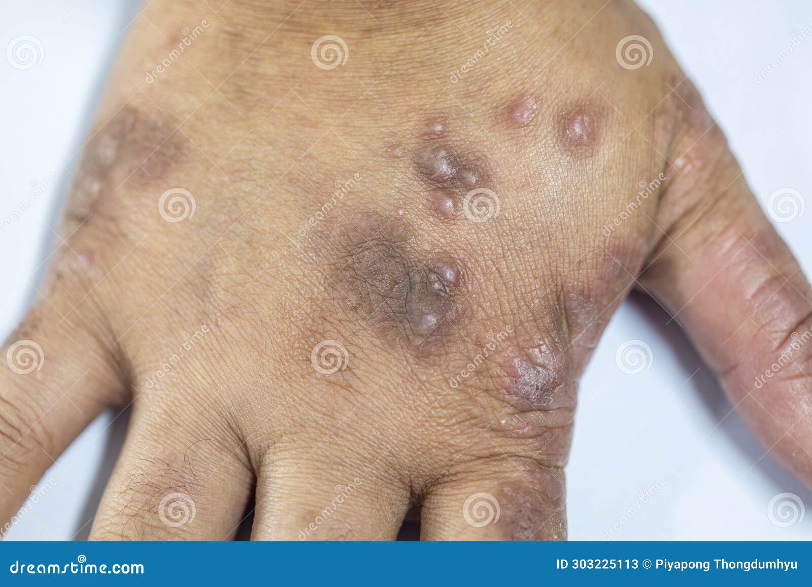 Atopic Dermatitis and Fungal Diseases on the Human Body. Stock Image ...