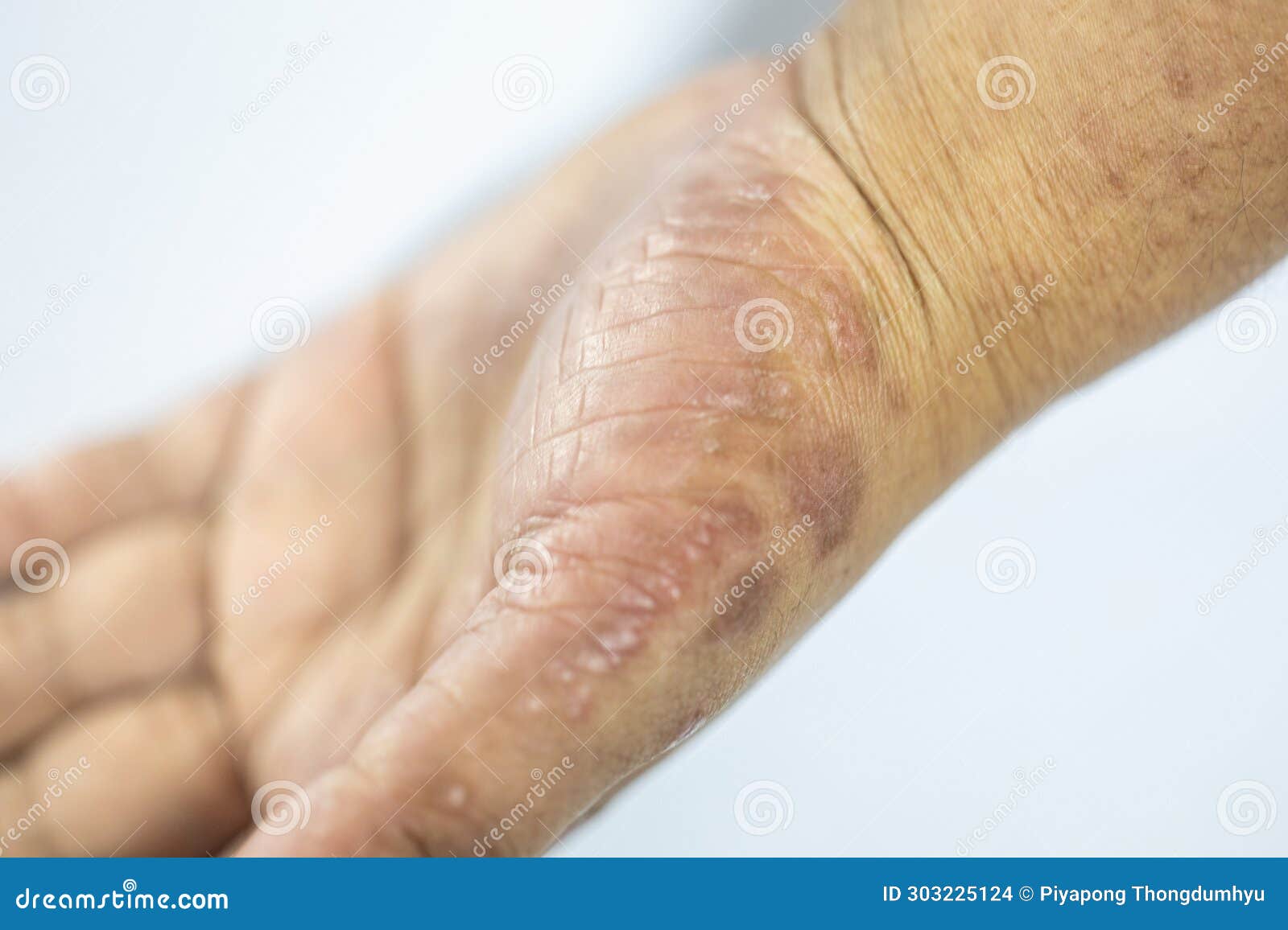 Atopic Dermatitis and Fungal Diseases on the Human Body. Stock Photo ...