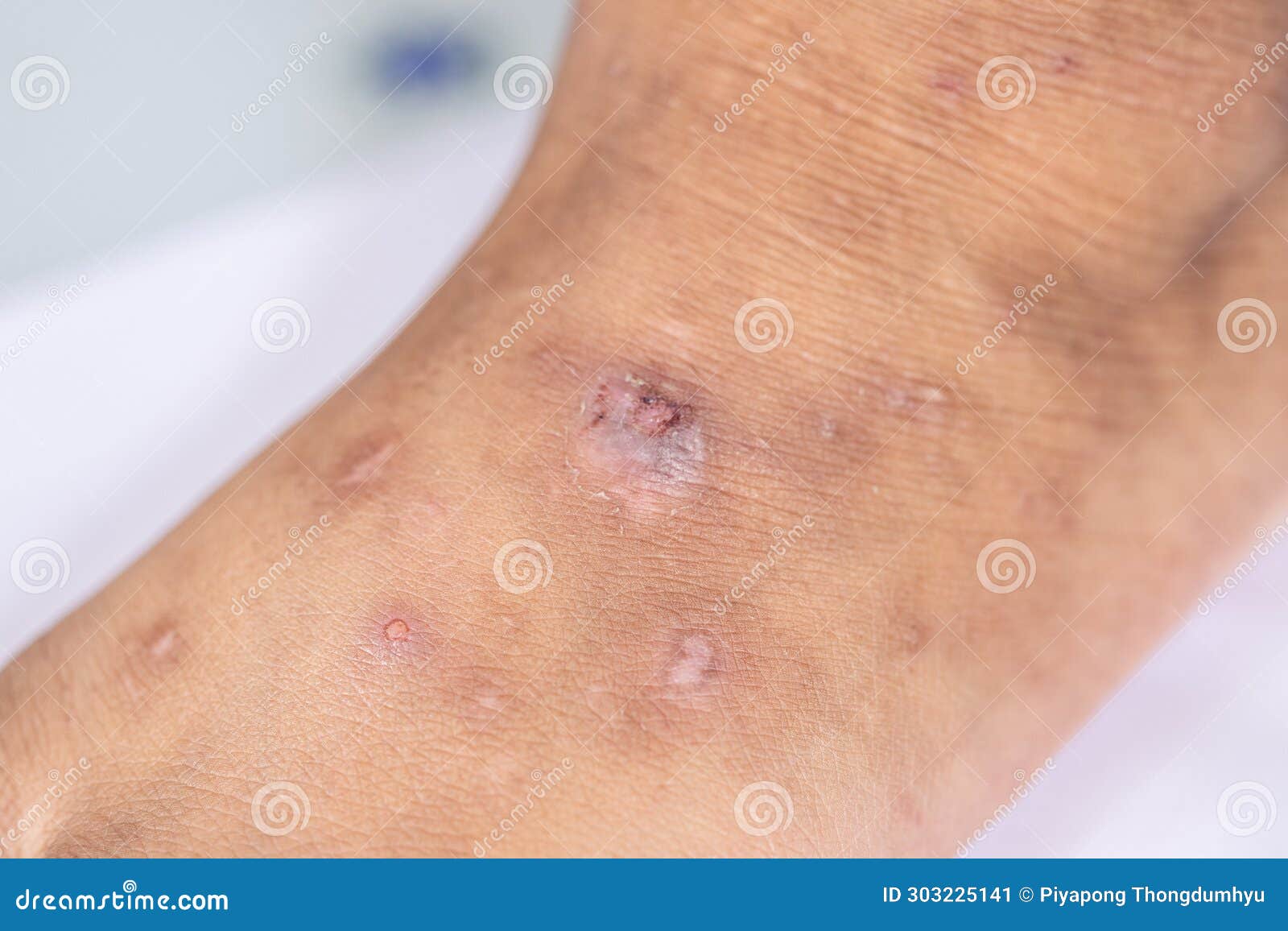 Atopic Dermatitis and Fungal Diseases on the Human Body. Stock Image ...
