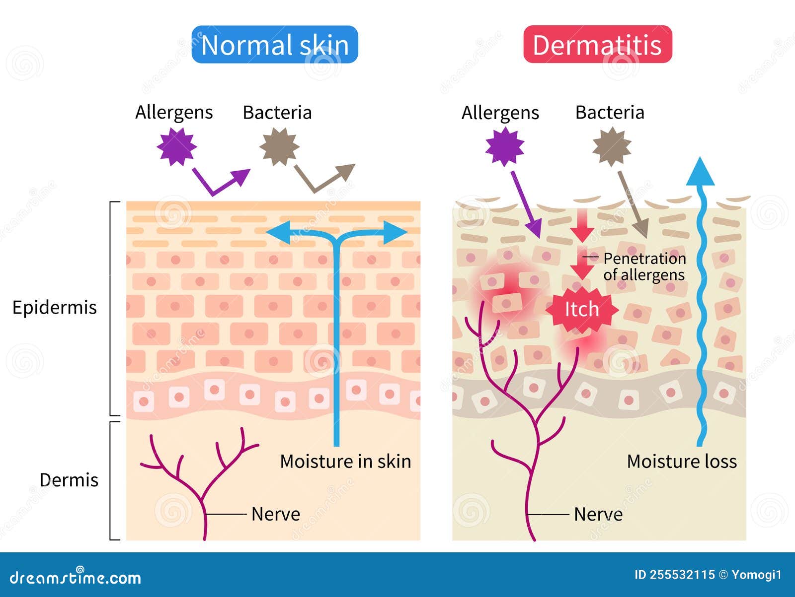 Atopic Dermatitis Eczema And Normal Skin Cell Illustration Healthy