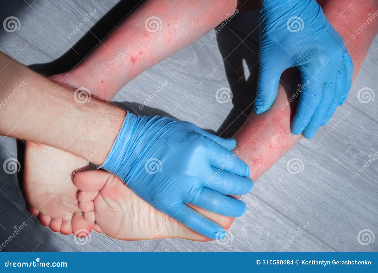 Atopic Dermatitis on the Legs of a Child Stock Photo - Image of itchy ...