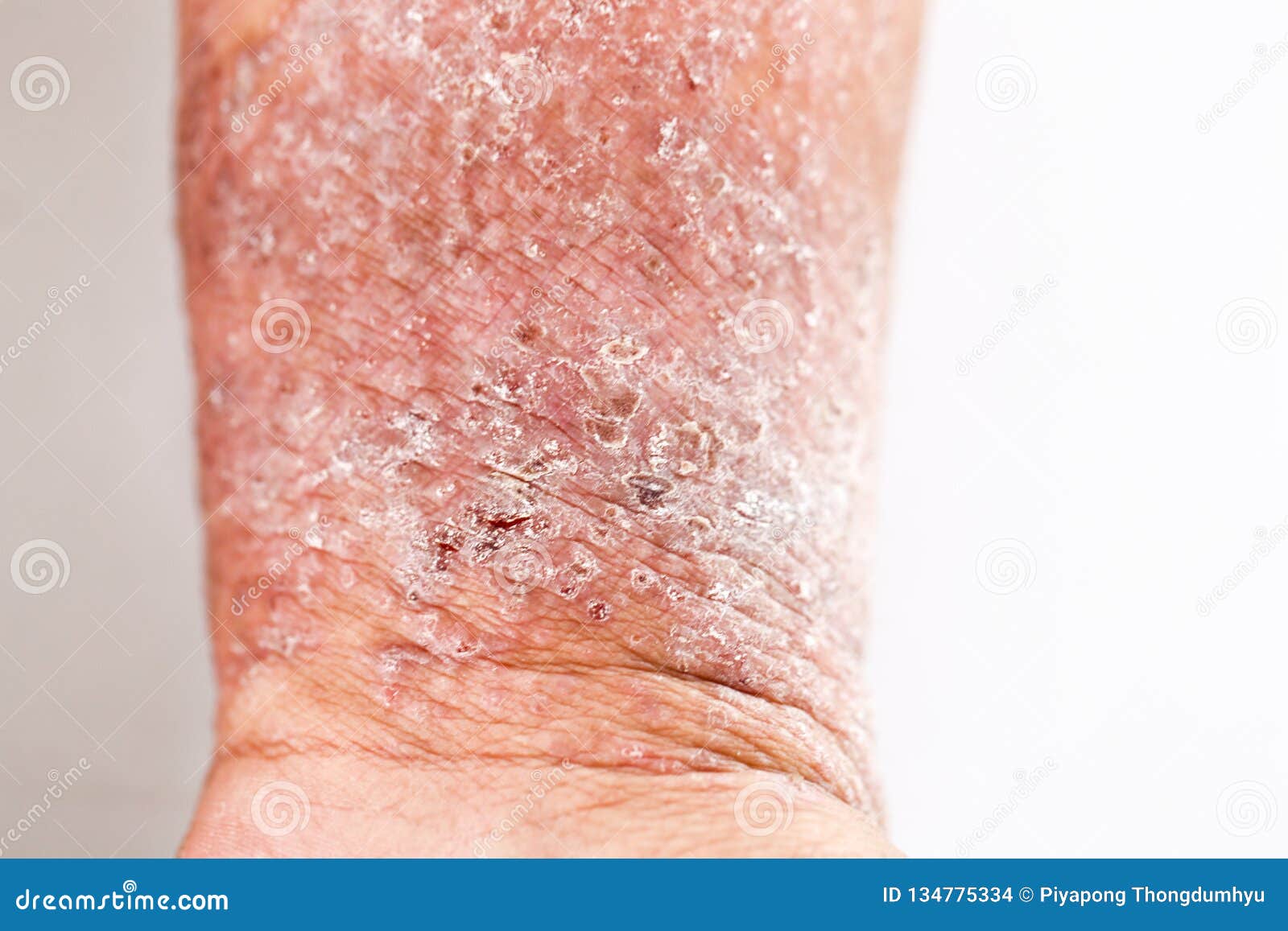 Atopic Dermatitisadvertentie Ook Als Atopic Eczema Wordt Bekend Is Een Type Van Ontsteking Van