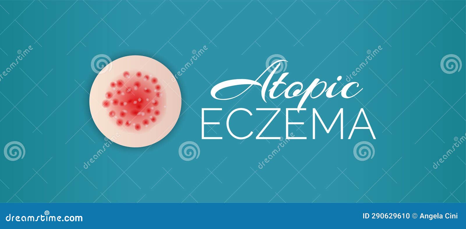 Atopic Eczema Background Illustration Banner Stock Illustration ...