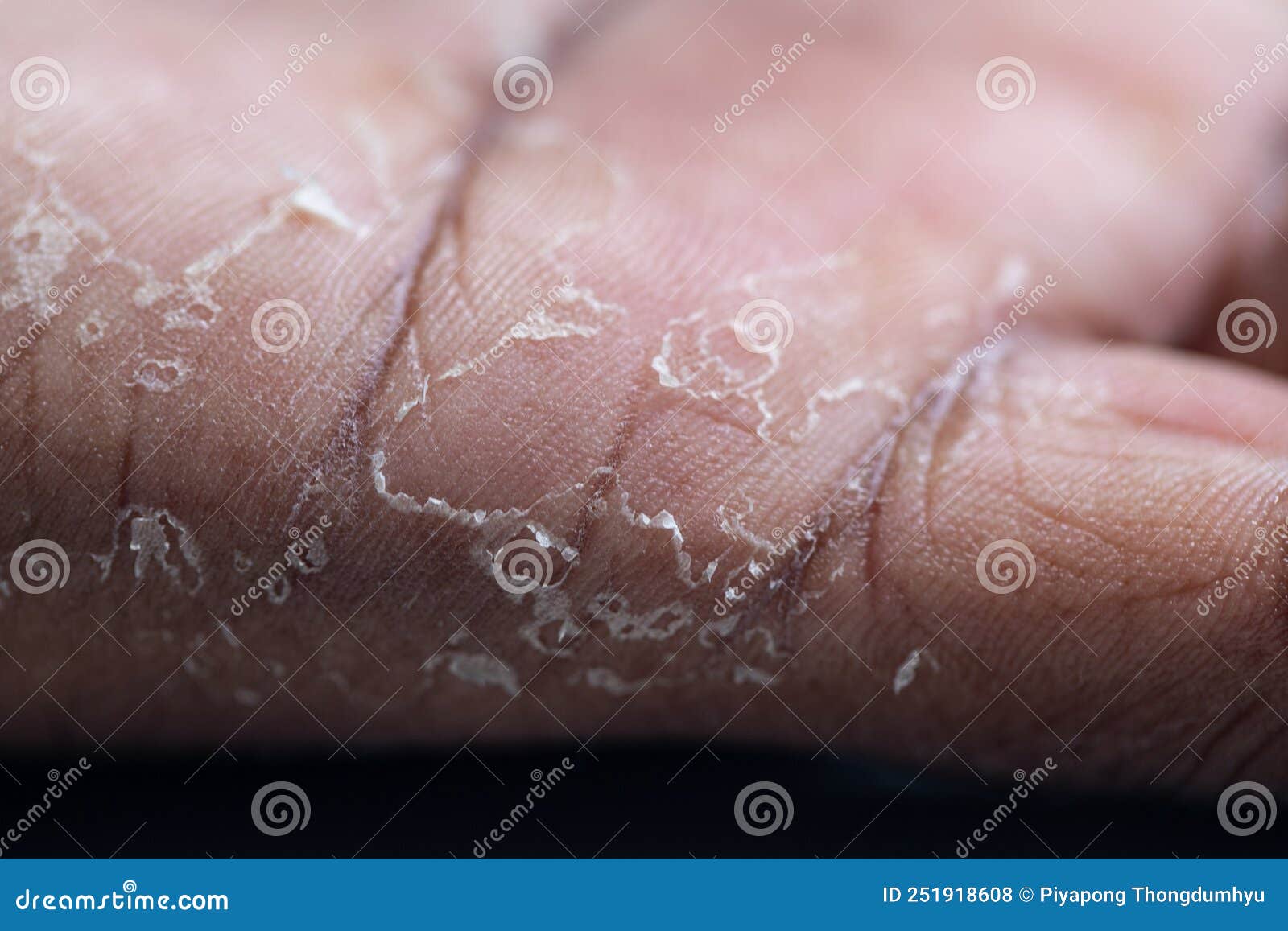 Atopic Eczema And Fungal Diseases On The Human Body. Royalty-Free Stock ...