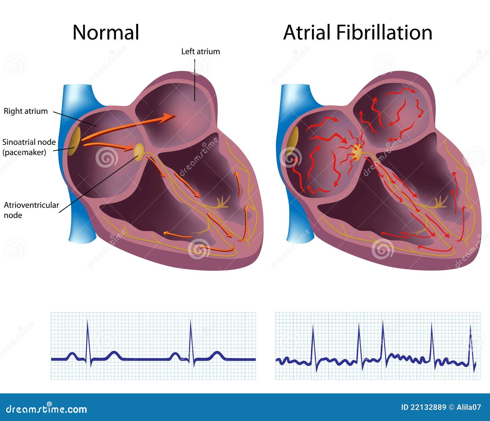 Atrial fibrillatie vector illustratie. Illustration of patroon - 22132889