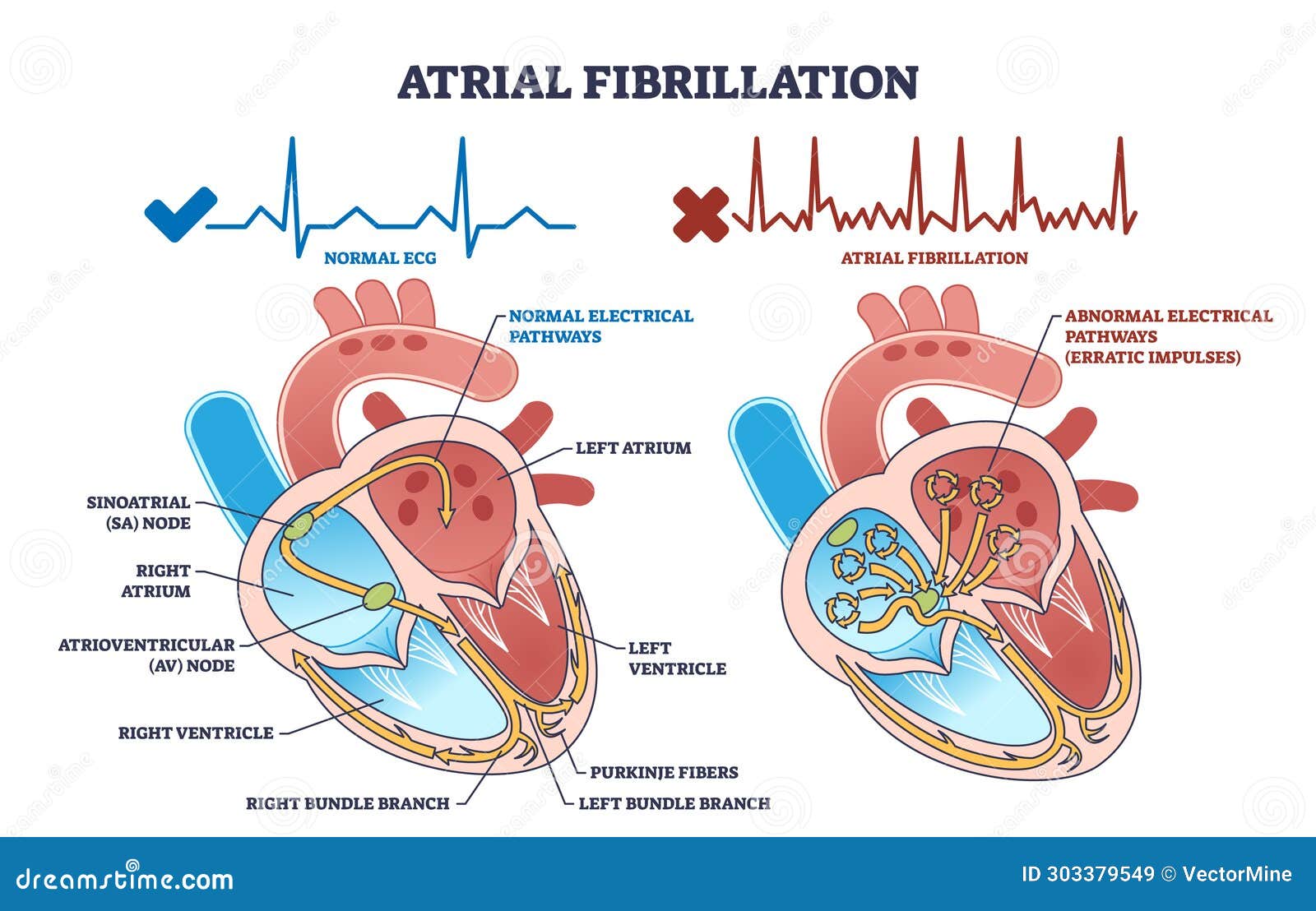 Ecg In Atrial Fibrillation 3d Illustration 291416625