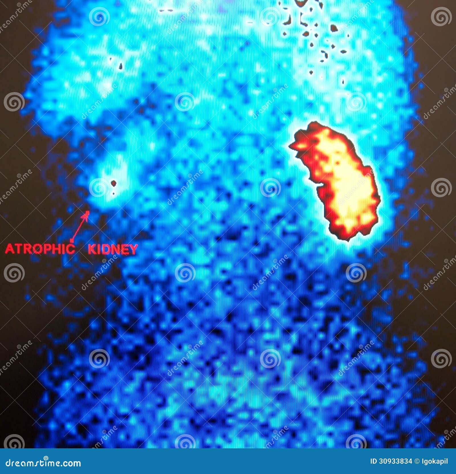 Atrophic Kidney Nuclear Medicine Stock Photo - Image of insufficiency ...