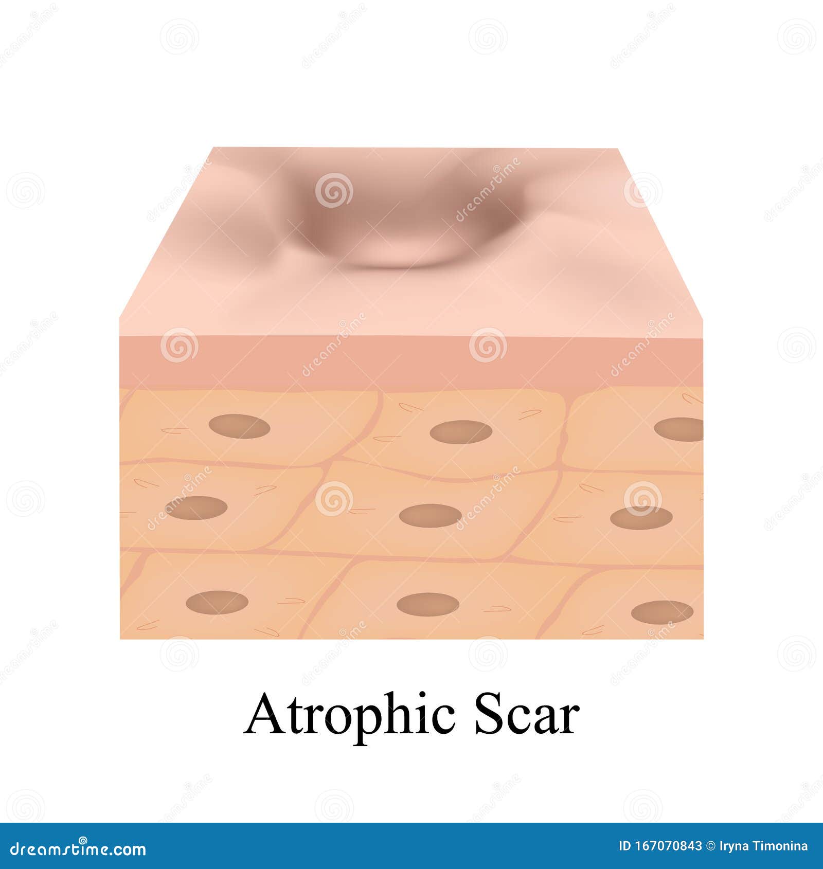 Atrophic Scars Acne Scar The Anatomical Structure Of The Skin With