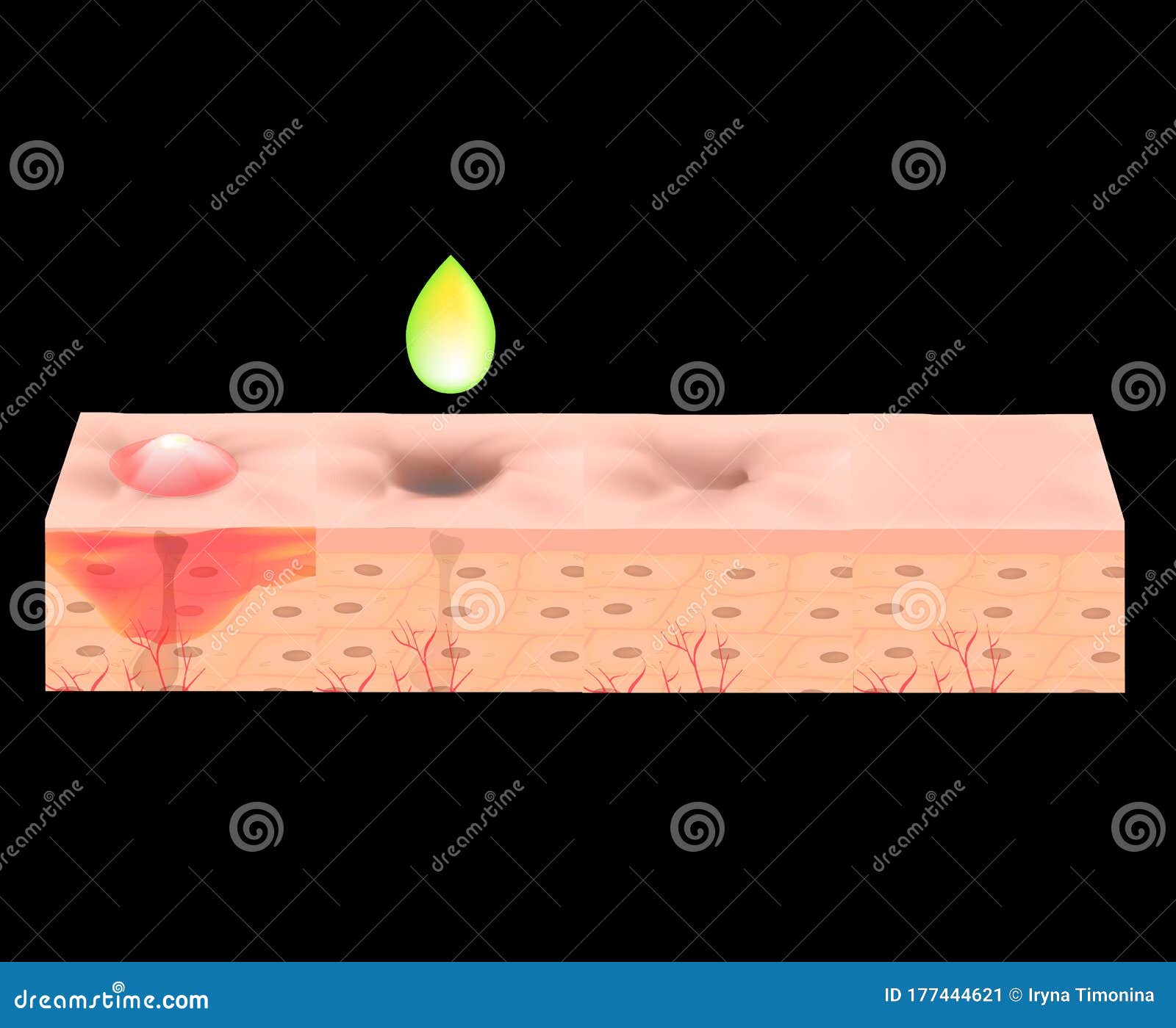 Atrophic Scars. Acne Scar. The Anatomical Structure Of The Skin With ...