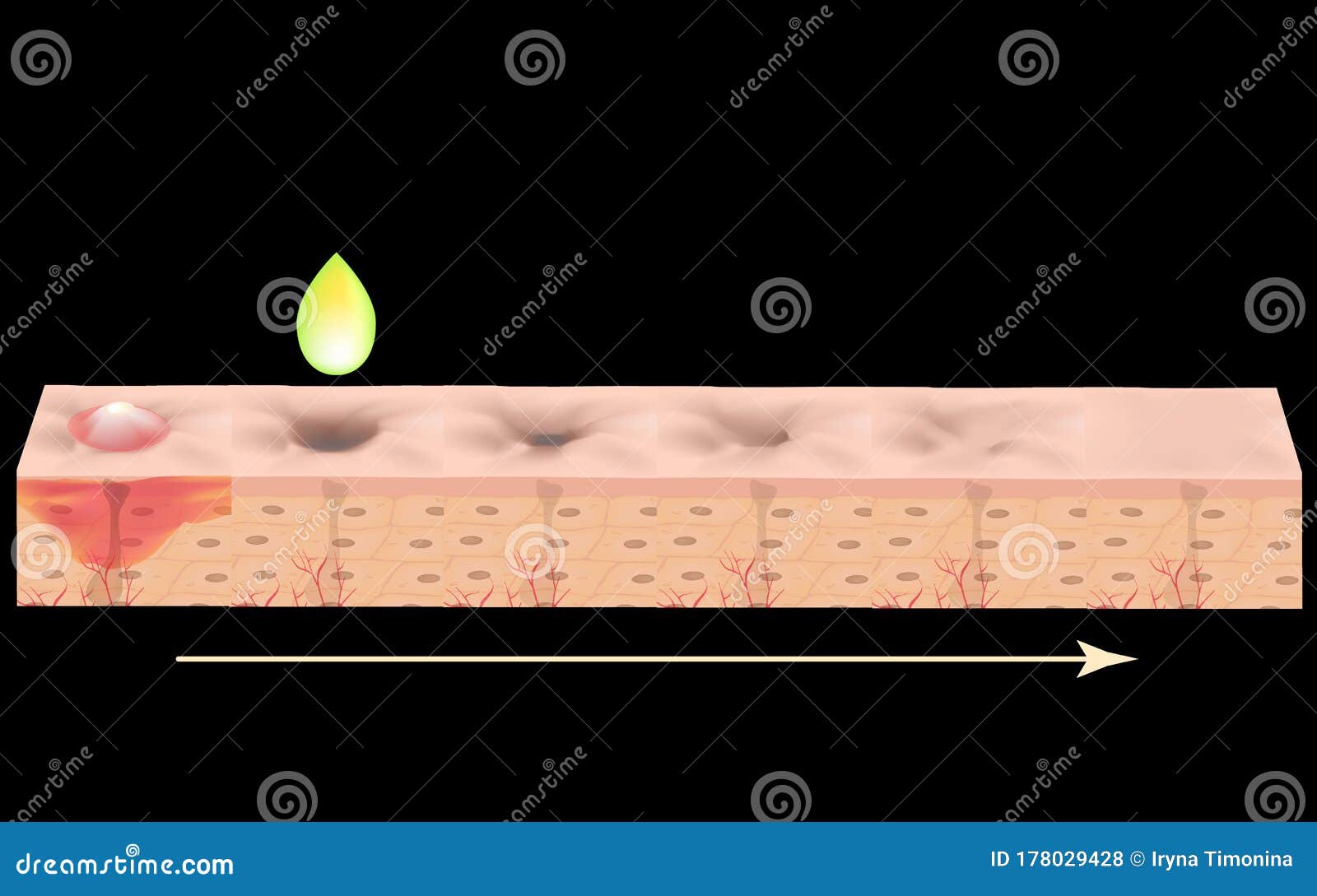 Atrophic Scars. Acne Scar. the Anatomical Structure of the Skin with ...