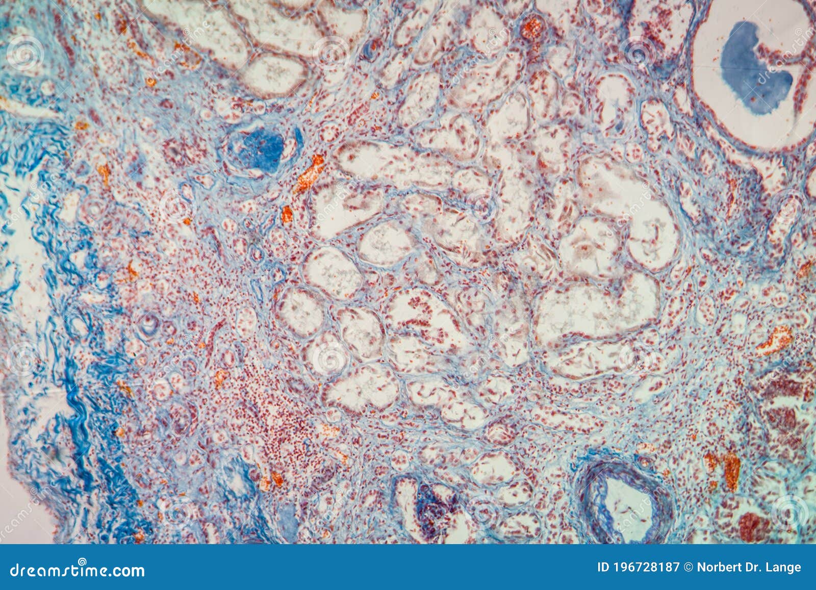 Atrophy kidney tissue stock image. Image of kidneys - 196728187
