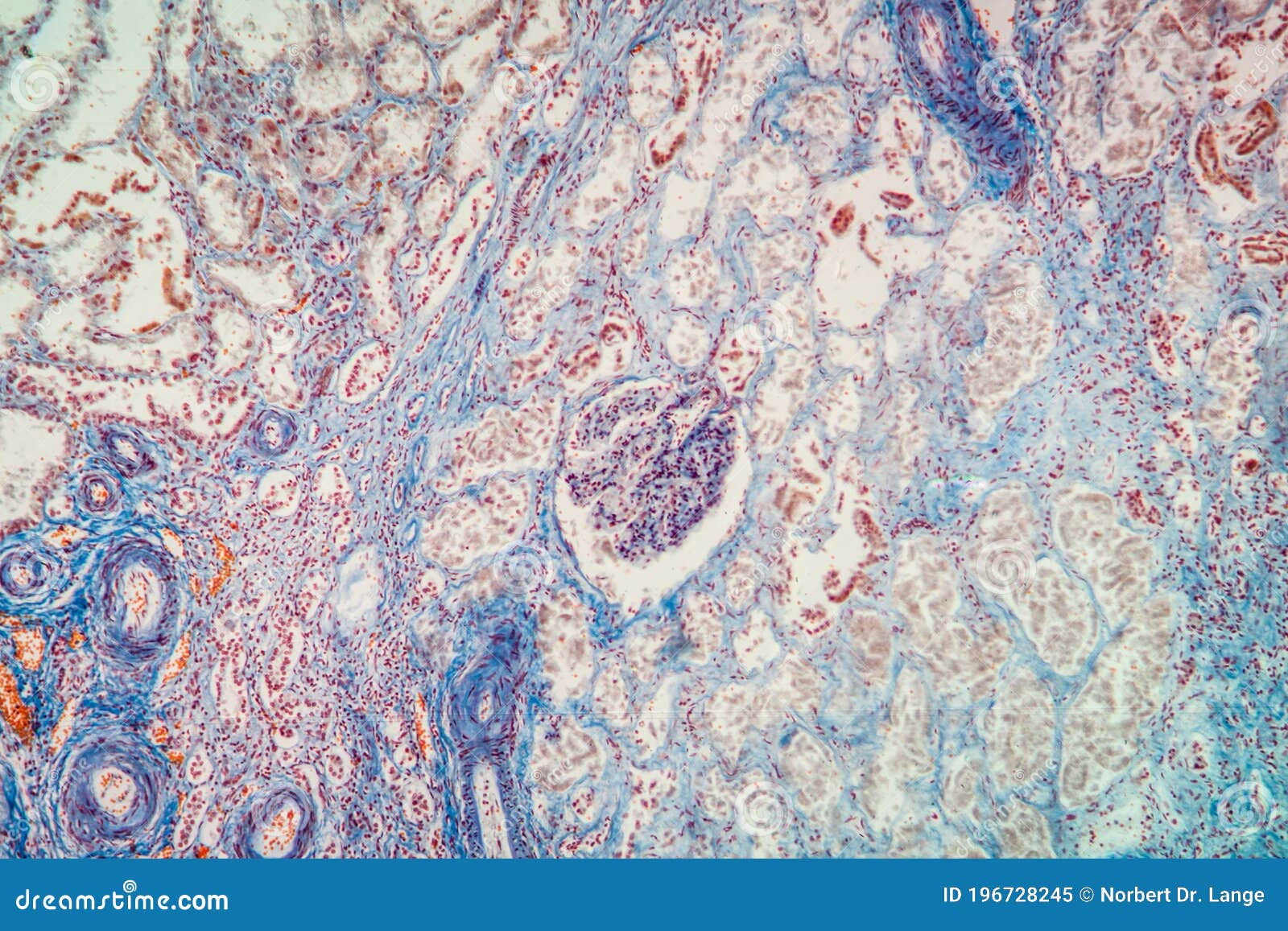 Atrophy kidney tissue stock image. Image of inflammation - 196728245
