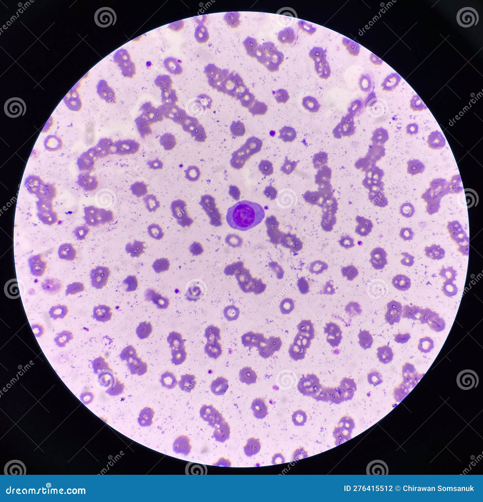 Atypical Lympho Cyte In Red Blood Cell Background Stock Photo ...