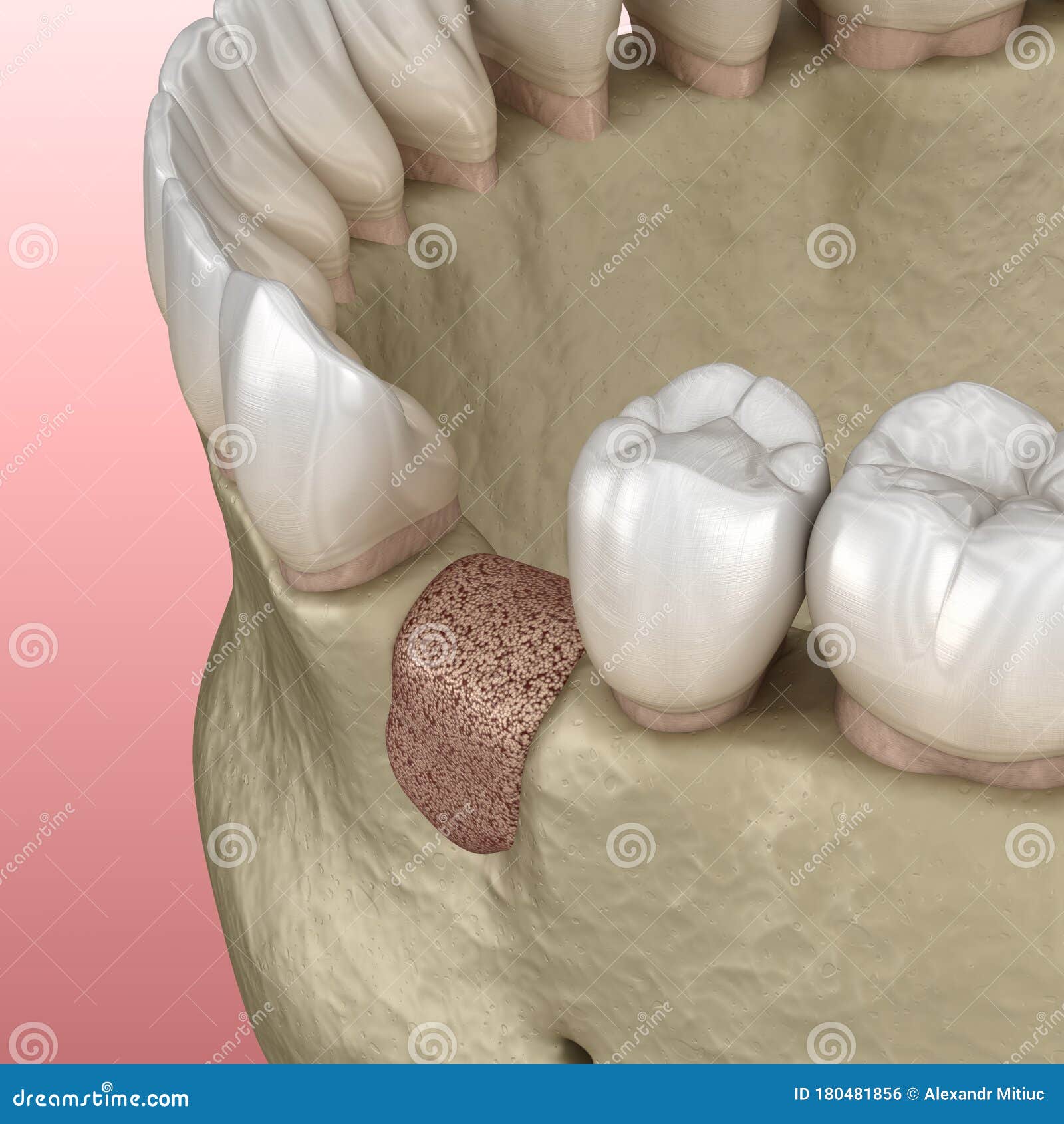 Augmentation Surgery - Adding Bone After Tooth Extraction. 3D ...