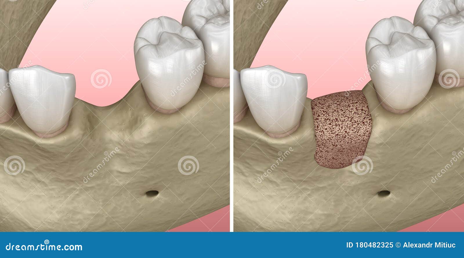 Augmentation Surgery - Adding New Bone. Illustration Stock Illustration ...