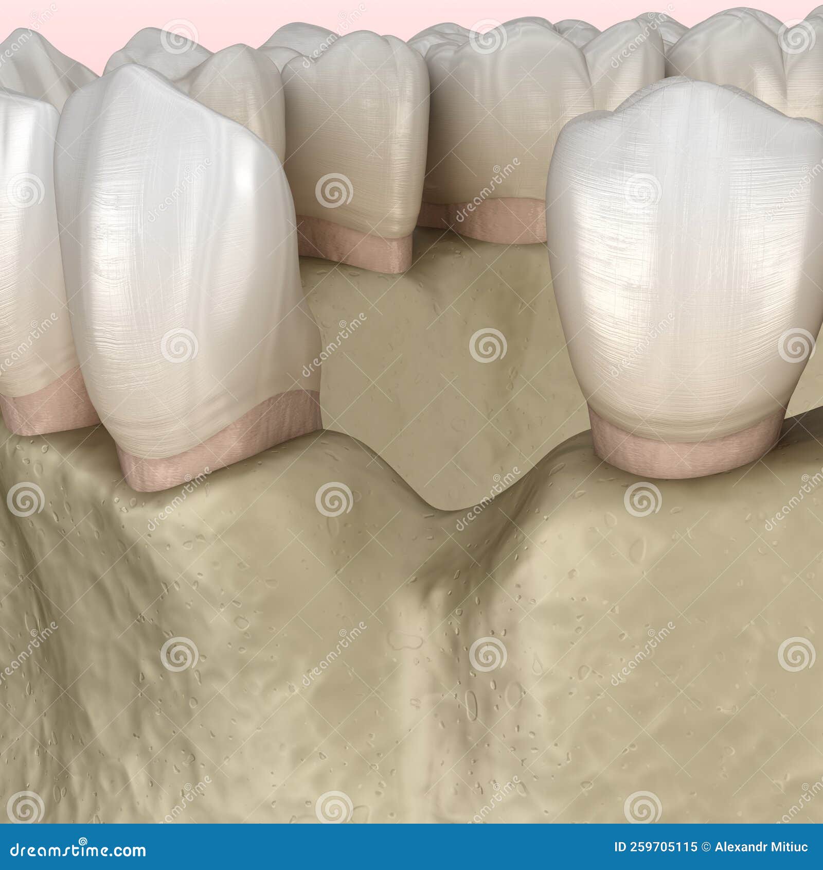 Augmentation Surgery - Adding New Bone. 3D Illustration Stock ...