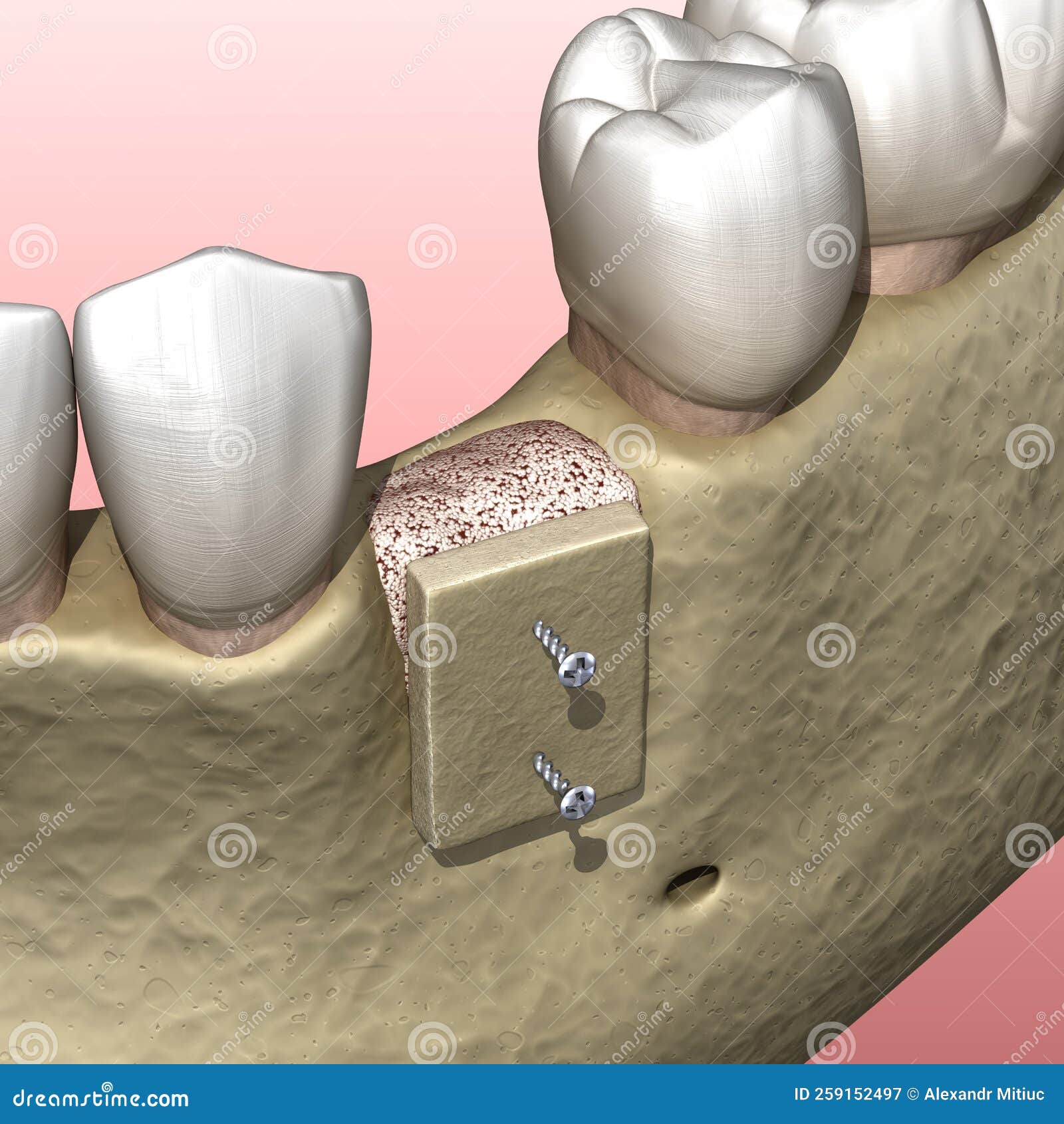 Augmentation Surgery - Adding Bone After Tooth Extraction. 3D ...