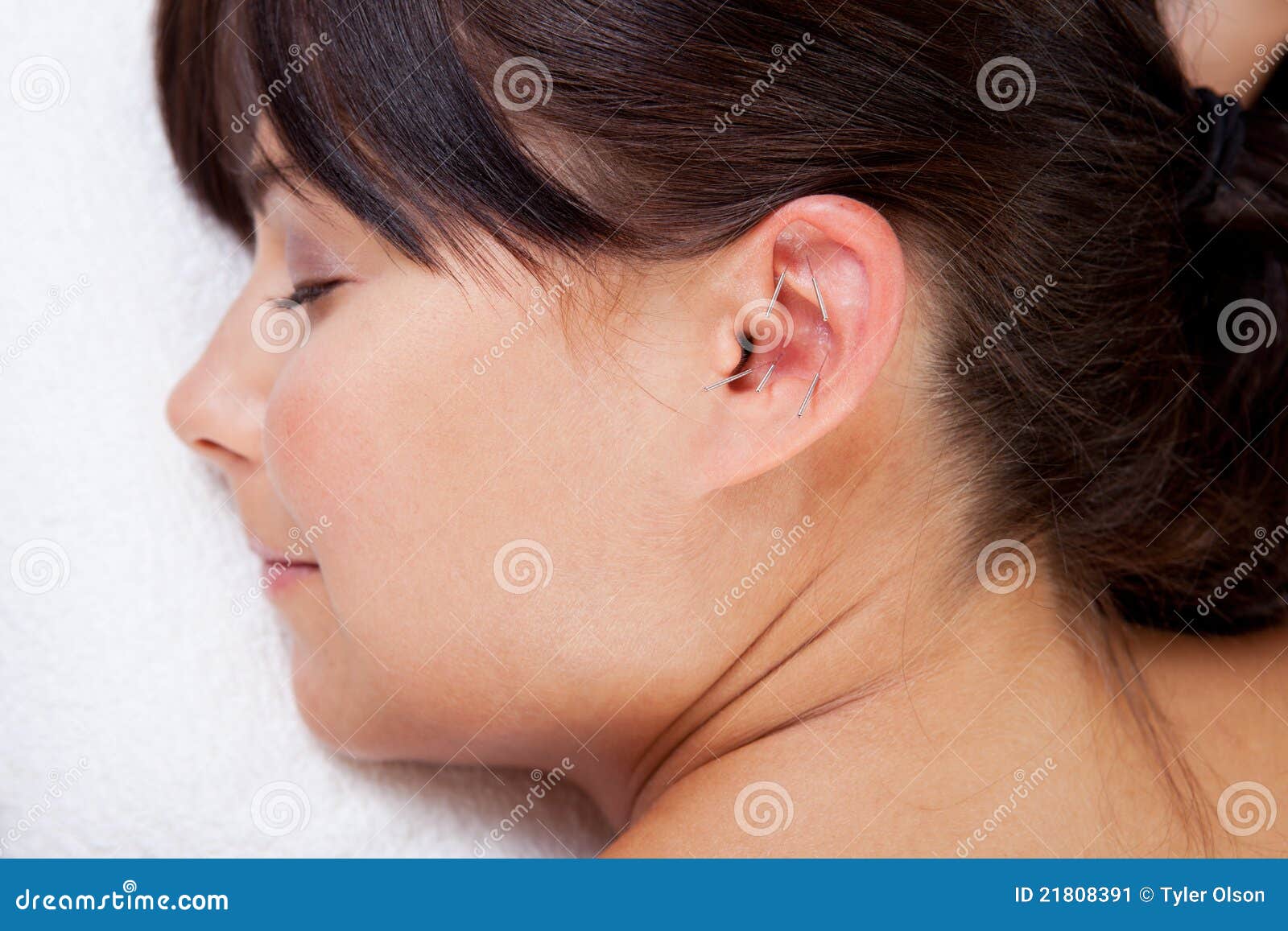 Aurical Acupuncture Treatment Stock Image - Image of female ...