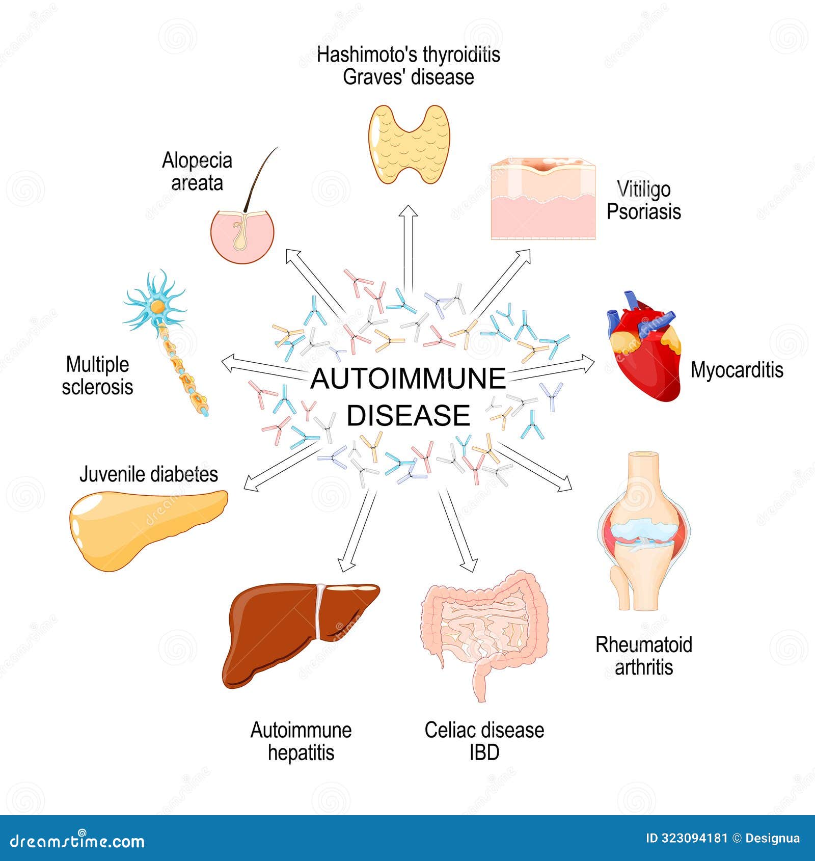 Autoimmune disease stock vector. Illustration of science - 323094181
