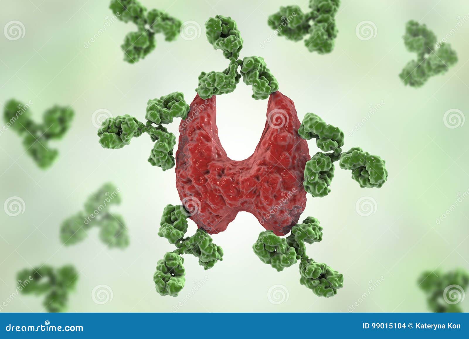 Autoimmune Thyreoiditis, Hashimoto-` S Krankheit Stock Abbildung ...