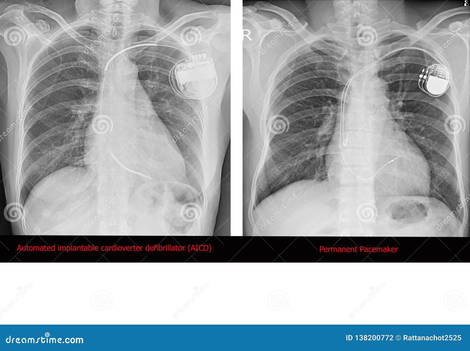 Icd Vs Pacemaker Cxr Cardiac Implantable Electronic Devices Cied On