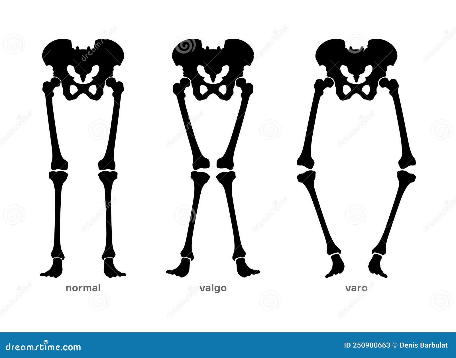 Normal and Deformed Leg Bones Position Stock Vector - Illustration of ...