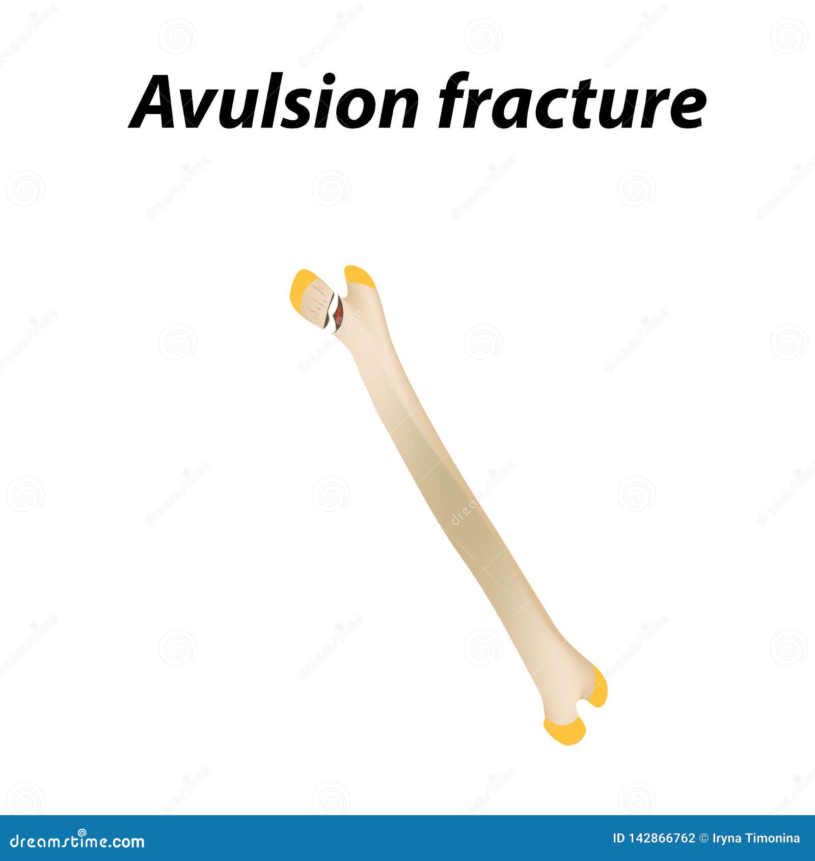 Avulsion Wound Animated Avulsion Of Skin: Top 10 Essential Steps To