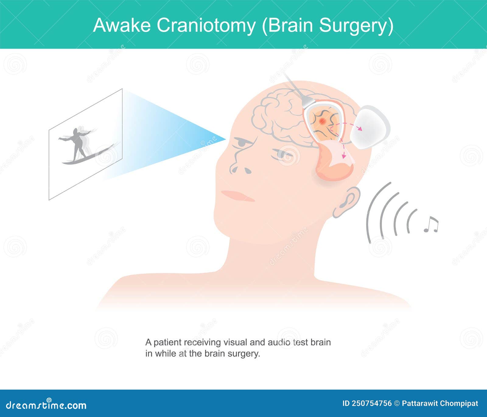 Awake Craniotomy. A Patient Receiving Visual And Audio Test Brain ...