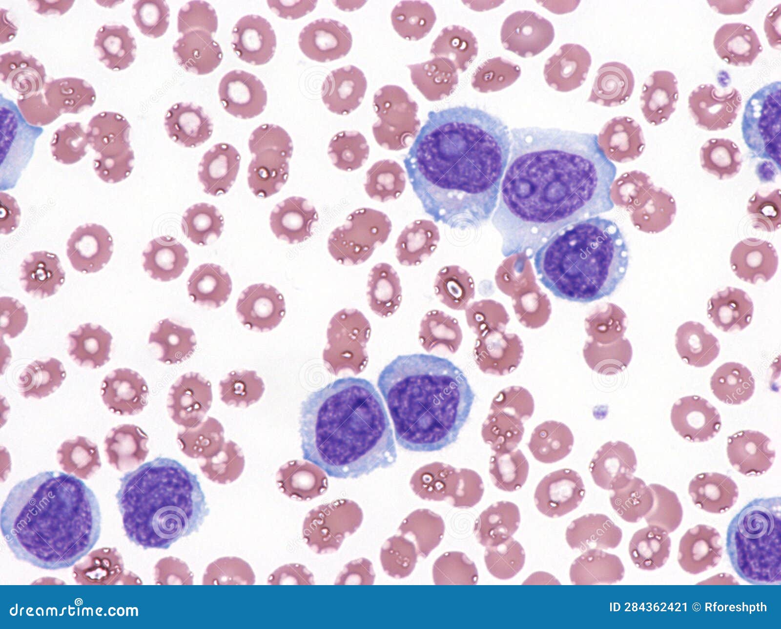 Pro Lymphocytic Leukemia