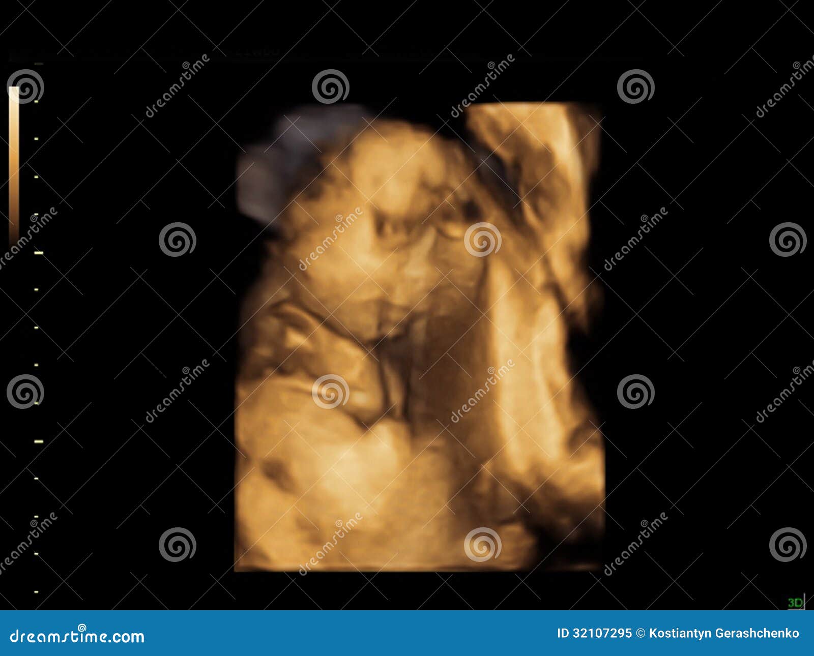 Baby Auf Dem Ultraschallbild Stockbild - Bild von bauch, medizinisch ...