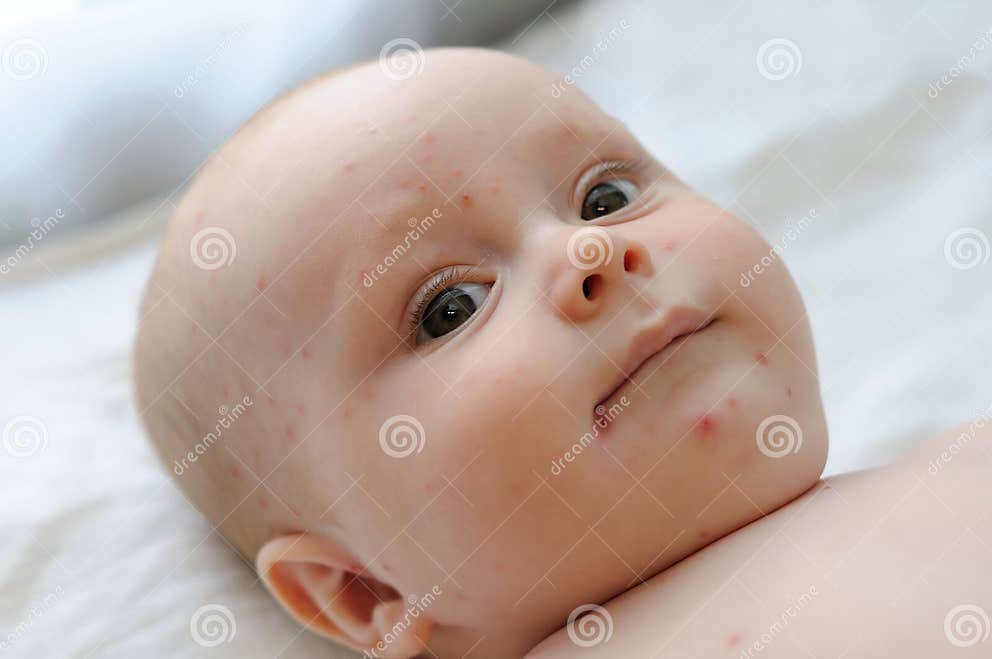 Baby with chicken pox stock image. Image of pock, caucasian - 24705229