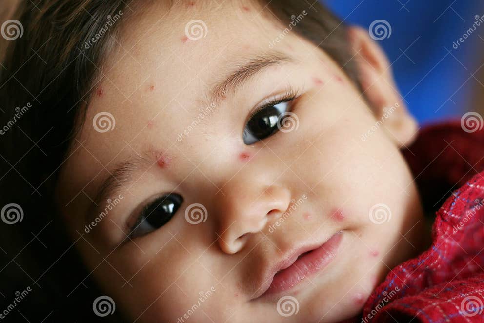 Baby with Chicken Pox stock image. Image of health, contagious - 2848125