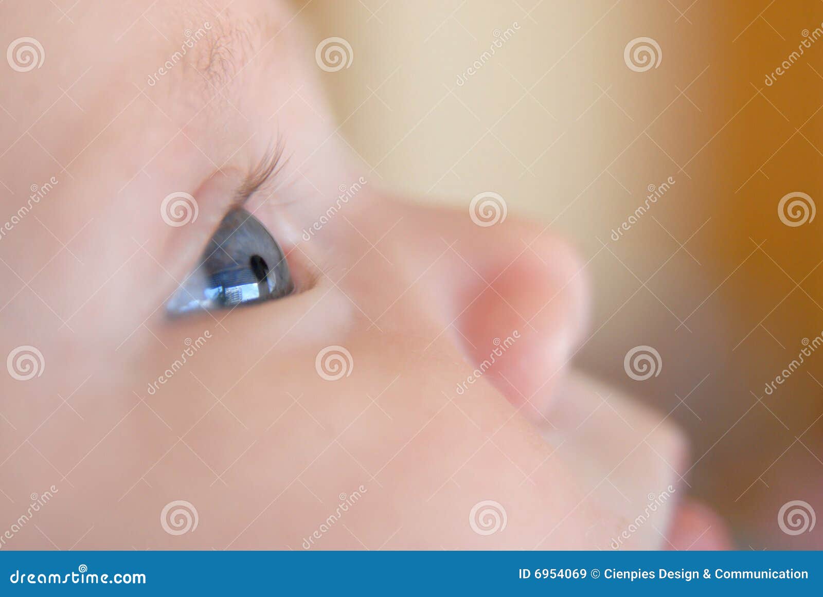A Baby With Eyes Full Of Rheum, Produced By Conjunctivitis ...