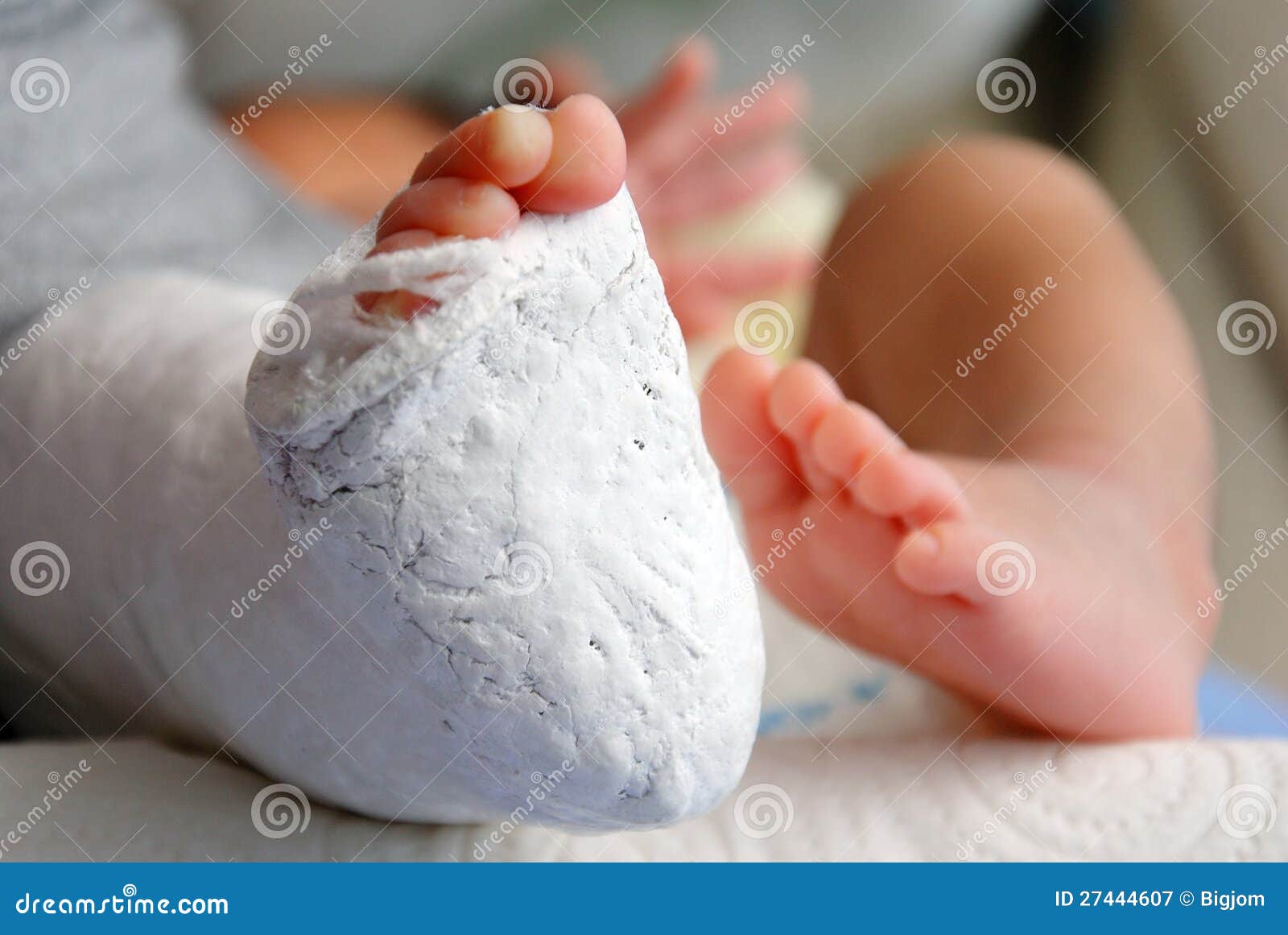 Baby Foot in Bandage and Cast Stock Image - Image of medical, cast ...