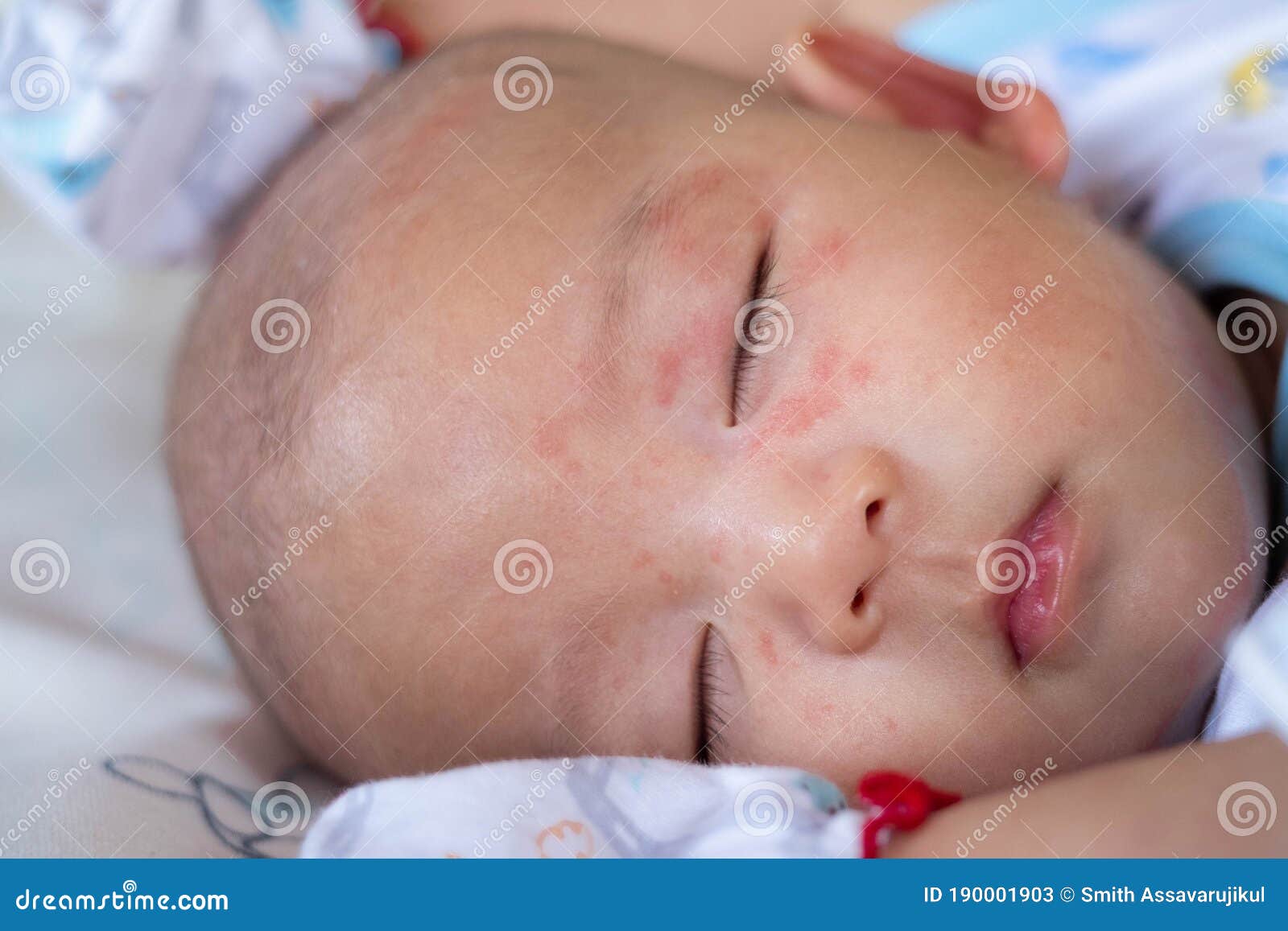Baby Infant Has an Allergic Reaction To the Face Stock Image - Image of ...