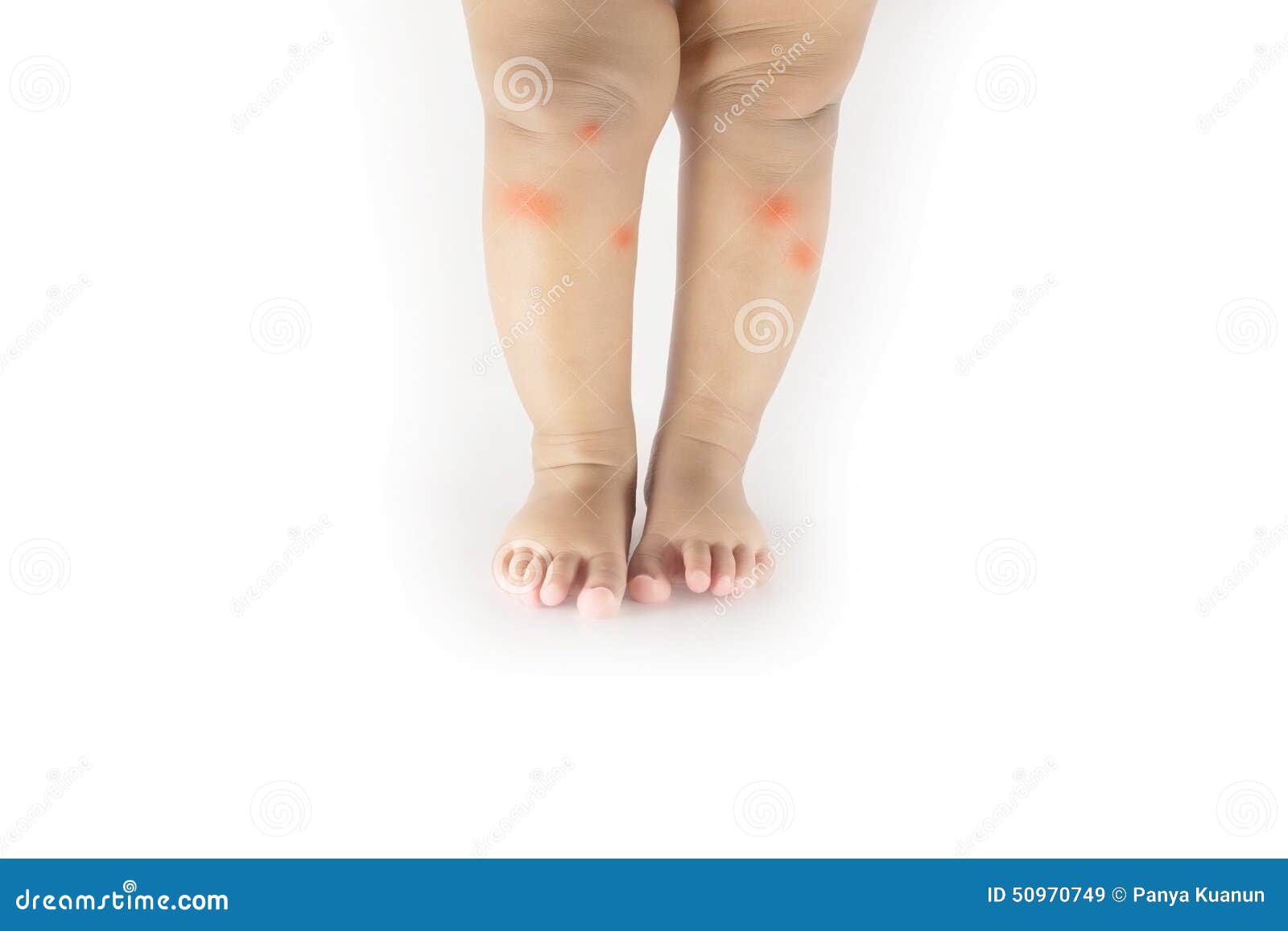 Baby Leg 7 Months by Mosquito Bites. Stock Image - Image of allergy ... Baby Leg 7 Months by Mosquito Bites. Stock Image - Image of allergy ...