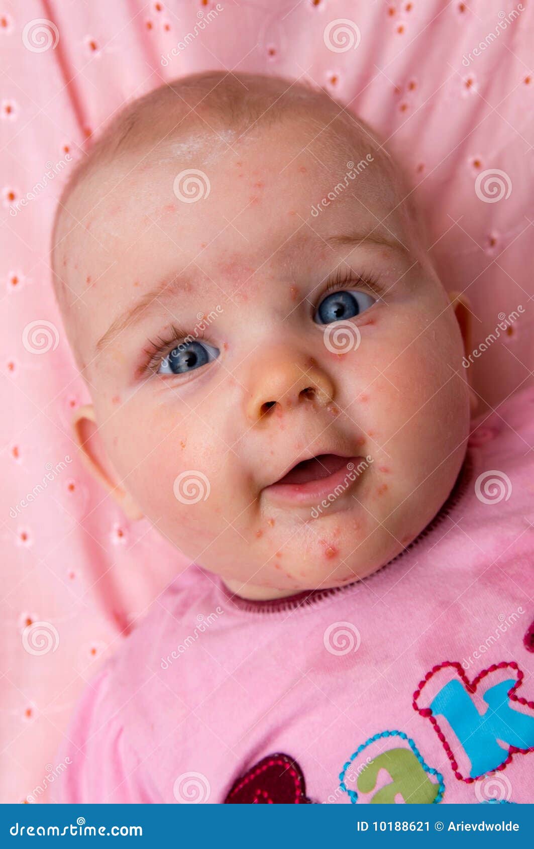 Baby met waterpokken stock afbeelding. Image of sluit - 10188621