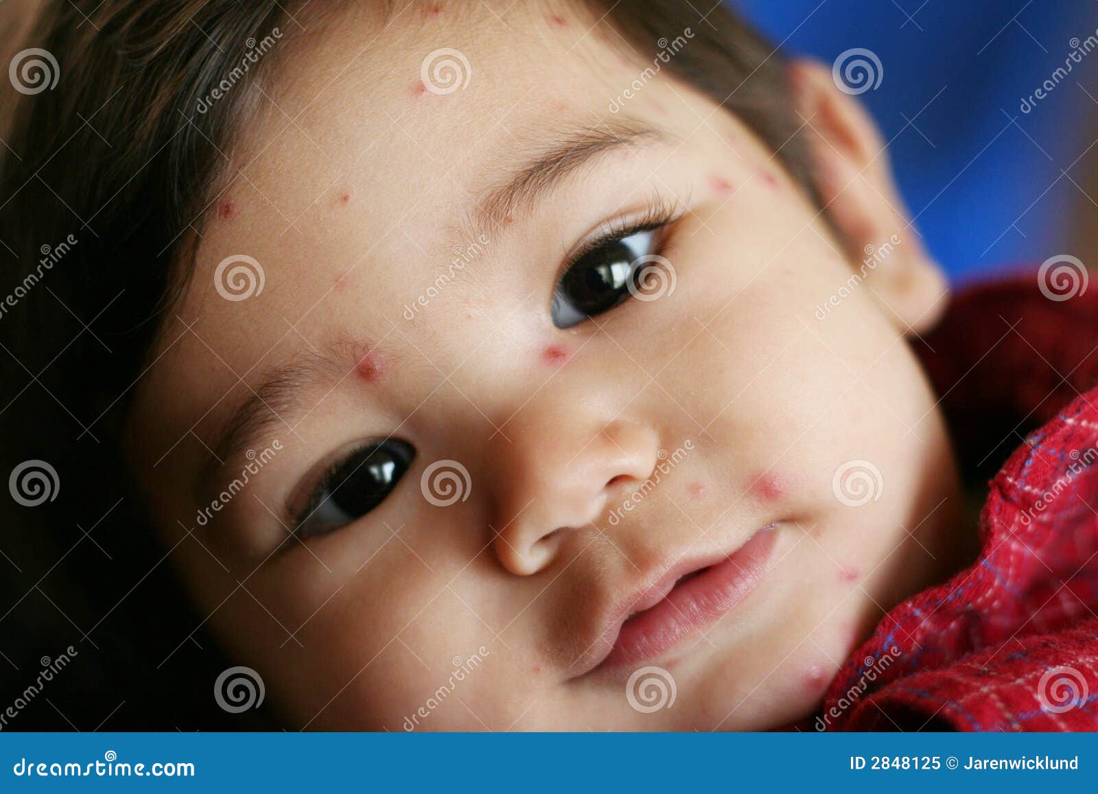 Baby met Waterpokken stock afbeelding. Image of kinderjaren - 2848125