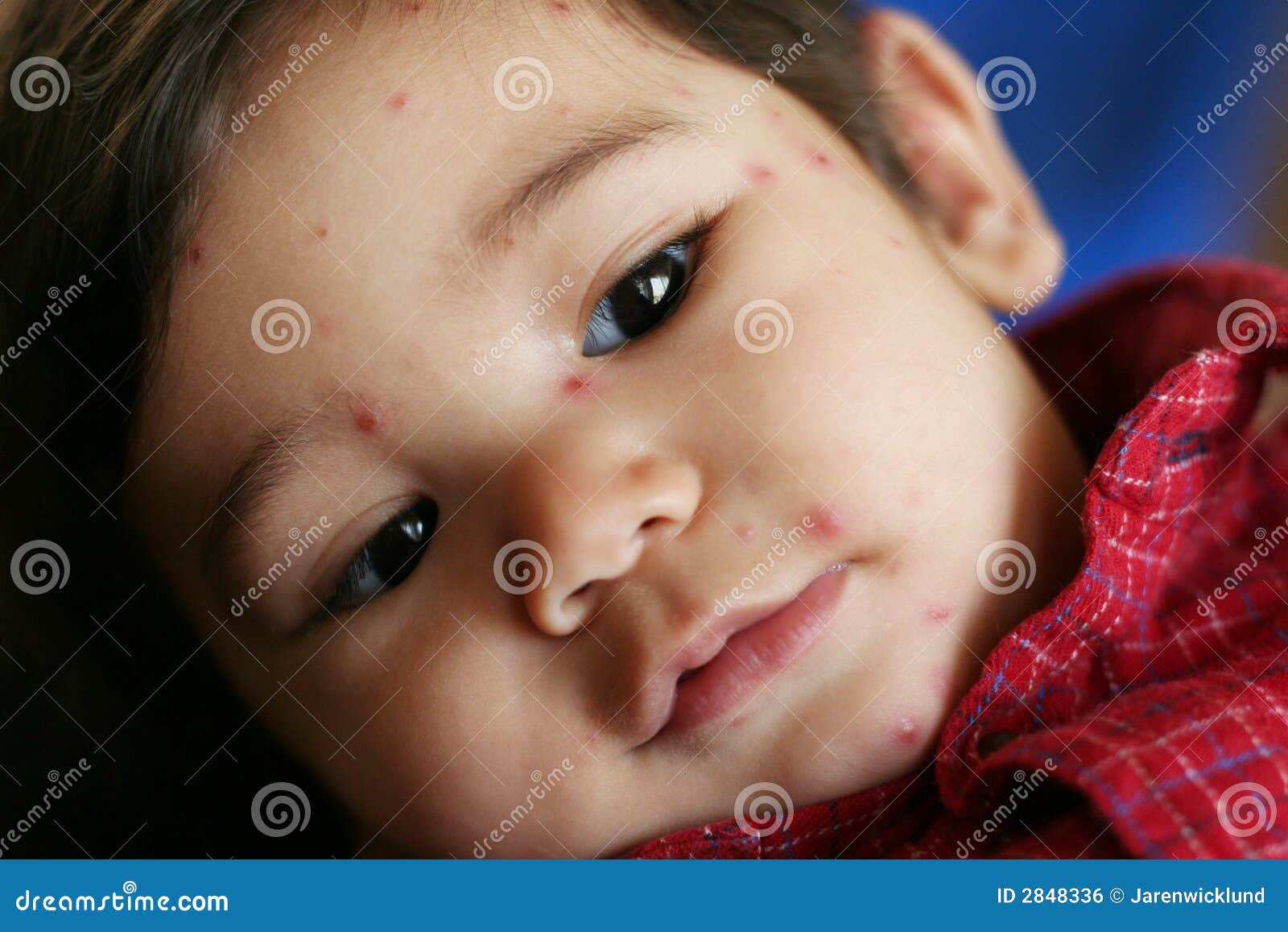 Baby met Waterpokken stock foto. Image of knap, aziatisch - 2848336