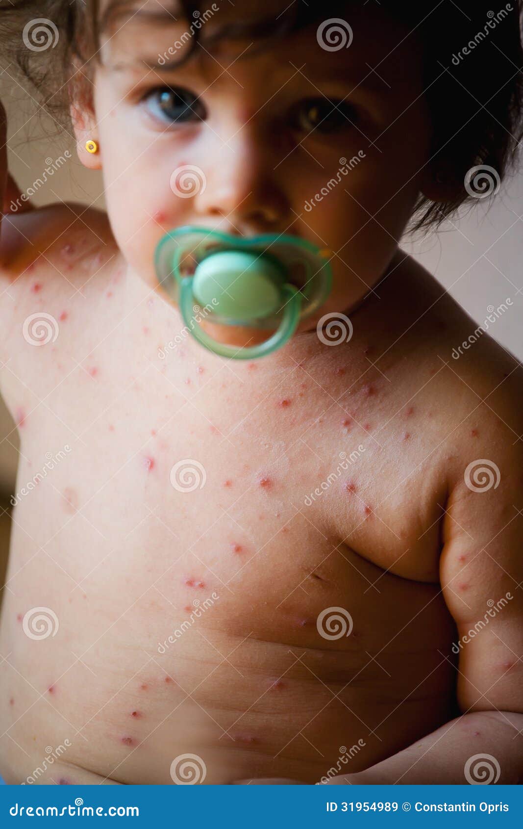 Baby met waterpokken stock afbeelding. Image of droevig - 31954989