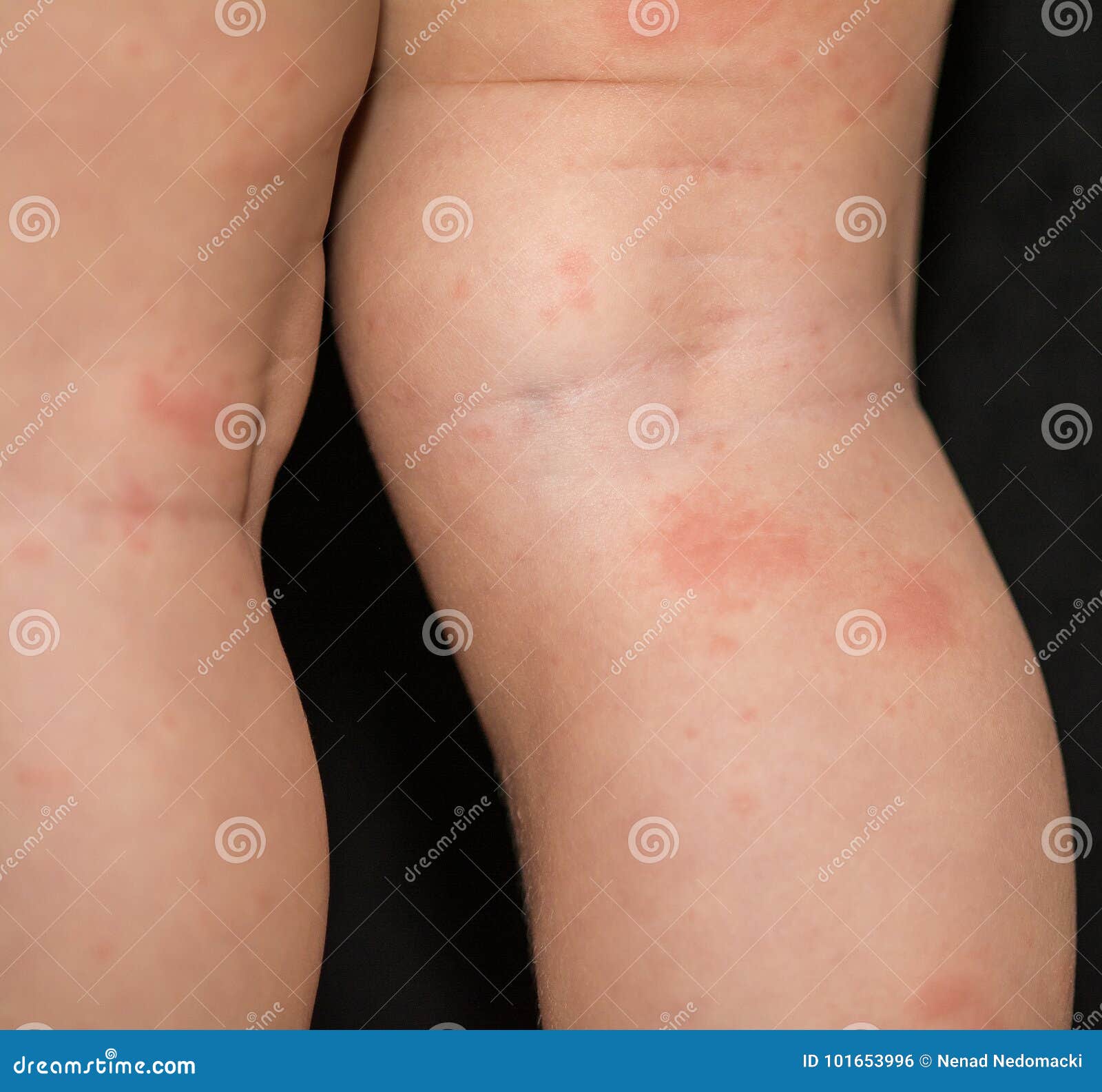 Baby with a rash stock photo. Image of babies, combing - 101653996