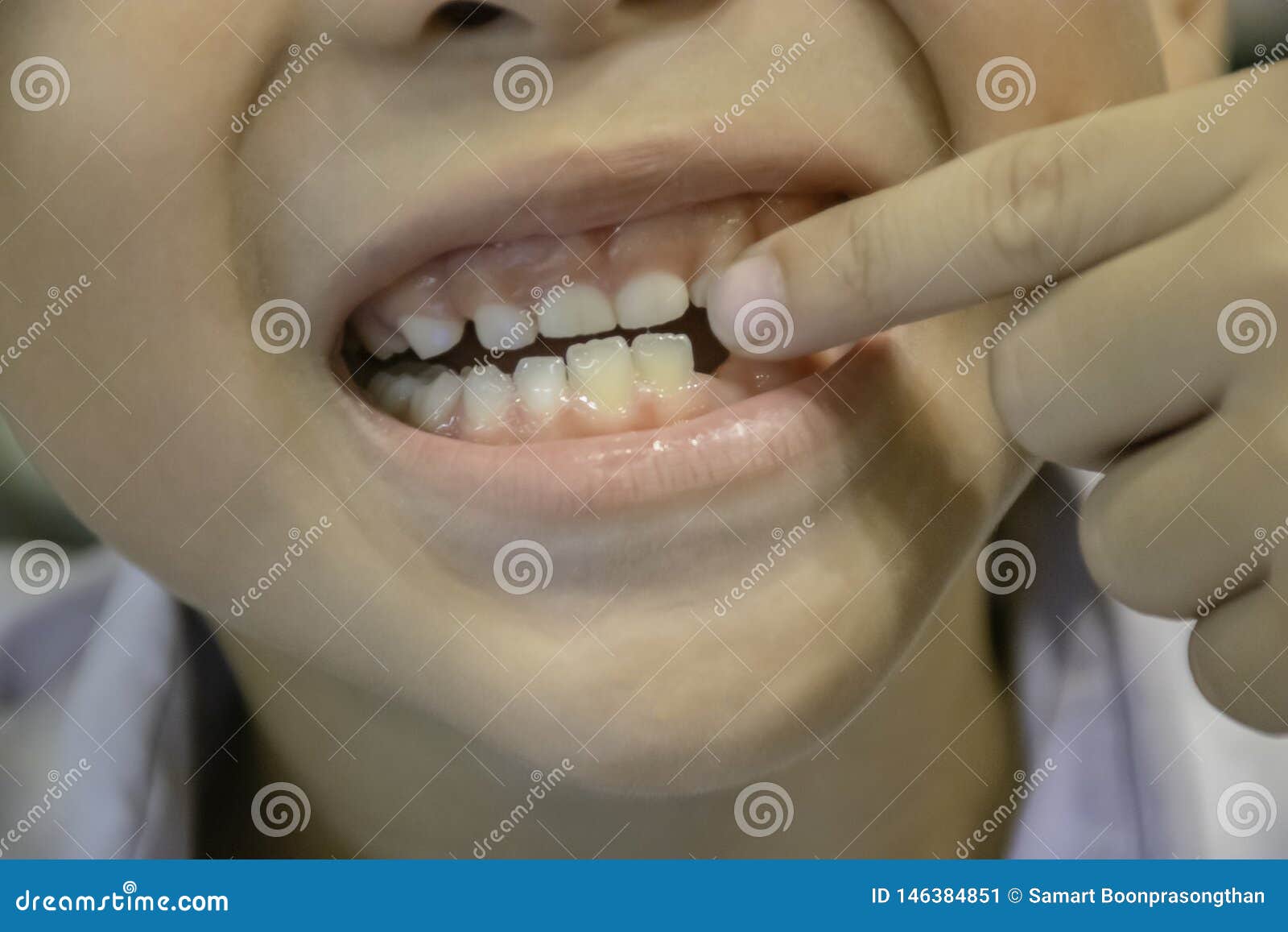 Baby Teeth are Just Dropped in the Mouth Stock Image - Image of clean ...