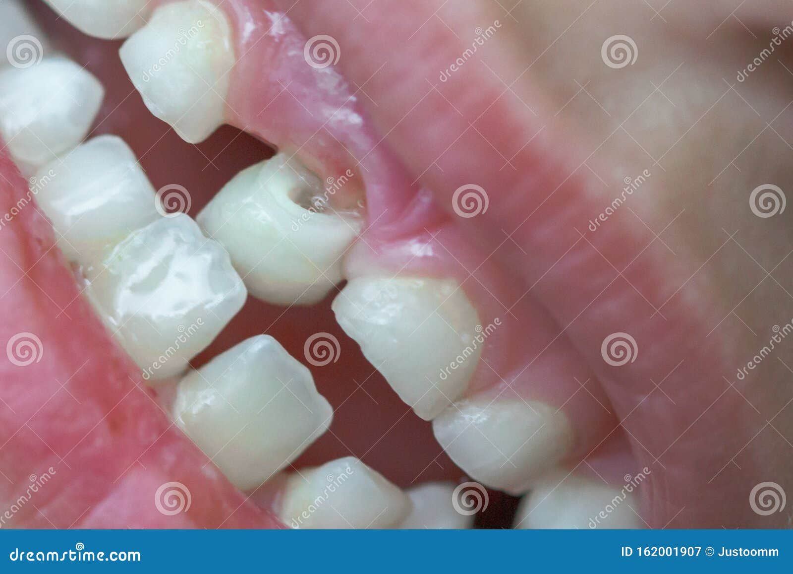 Baby Tooth, Close-up of the Tooth that Falls Macro Shot Stock Image ...