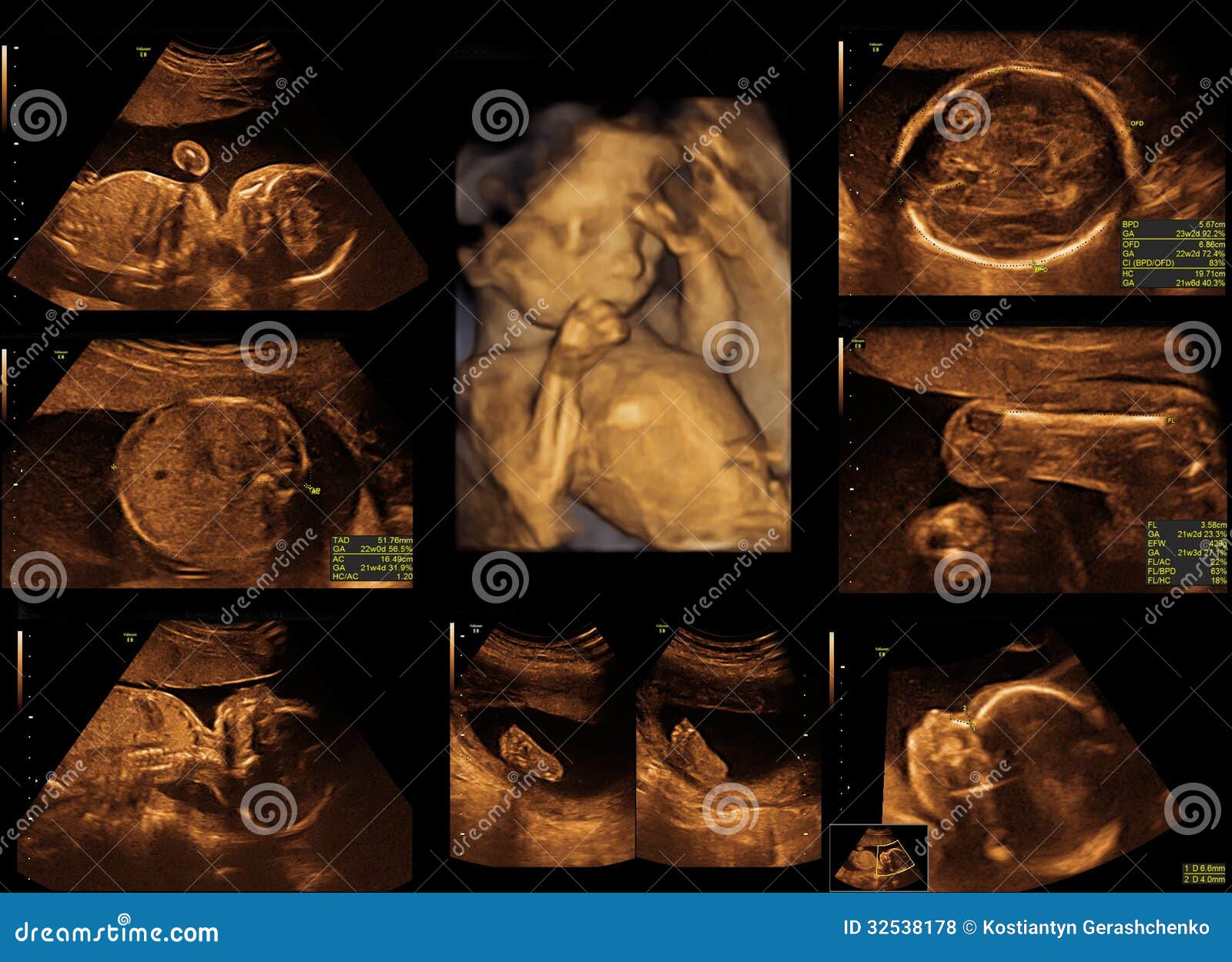 Baby on the Ultrasound Image Stock Photo - Image of life, embryo: 32538178
