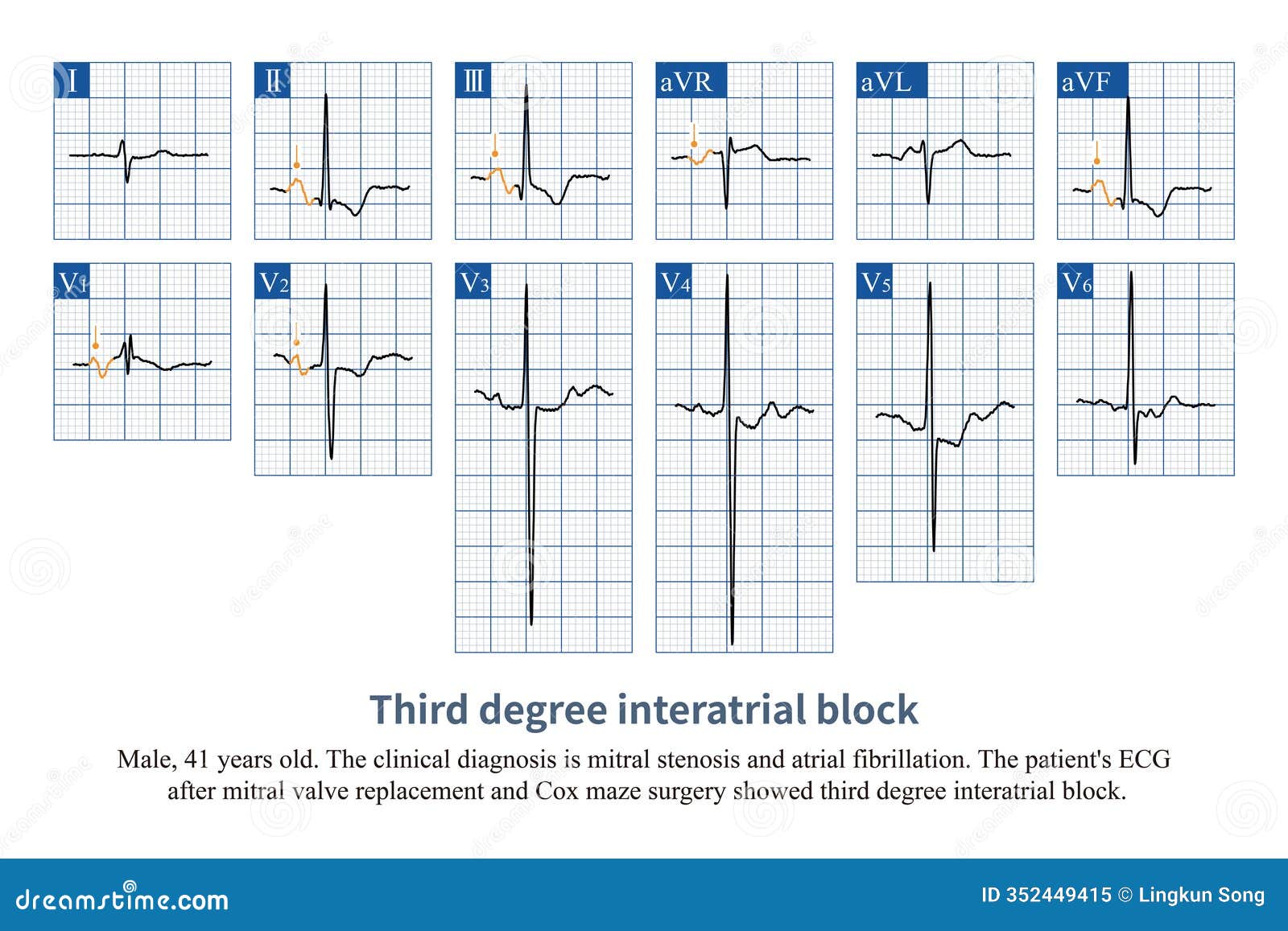 Third Degree Interatrial Block Stock Image - Image of wave, disorder ...