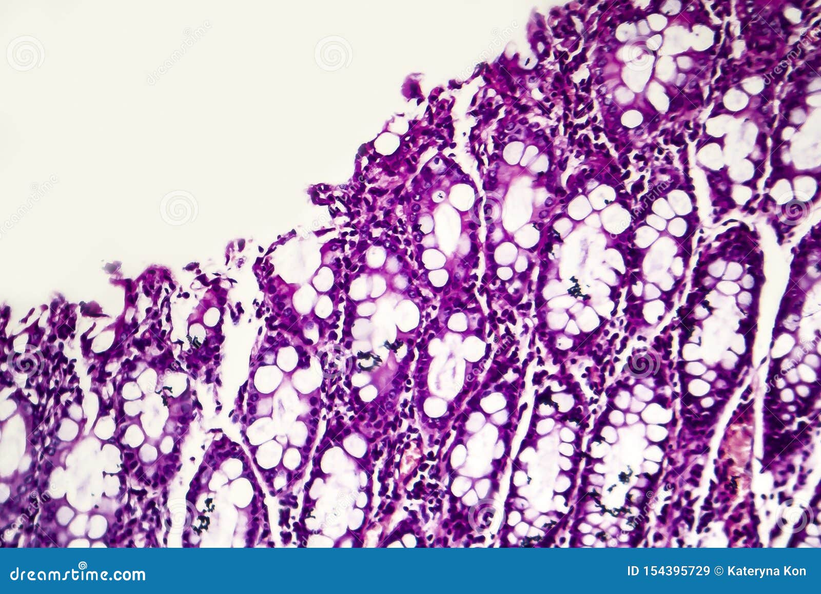 Bacillary Dysentery, Light Micrograph Stock Image - Image of ...