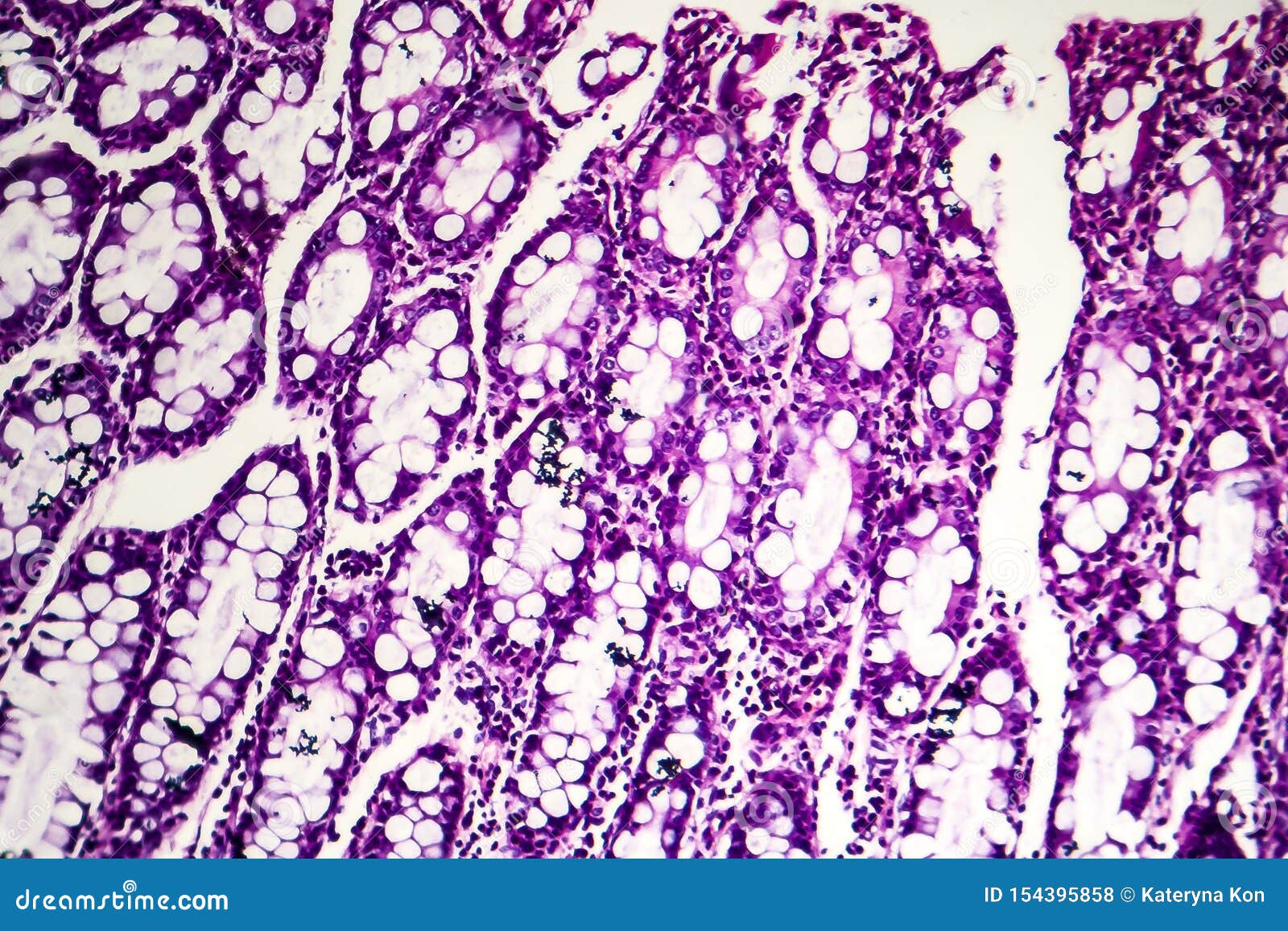 Bacillary Dysentery, Light Micrograph Stock Photo - Image of histology ...