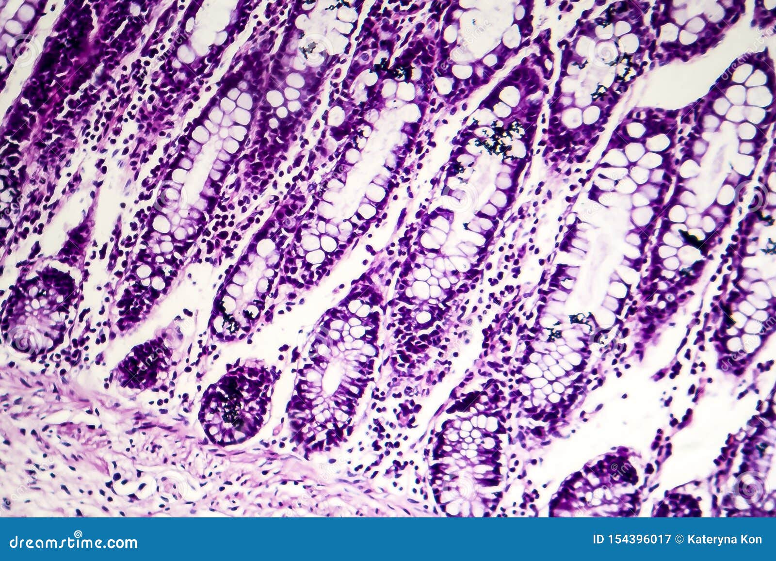 Bacillary Dysentery, Light Micrograph Stock Image - Image of coli ...