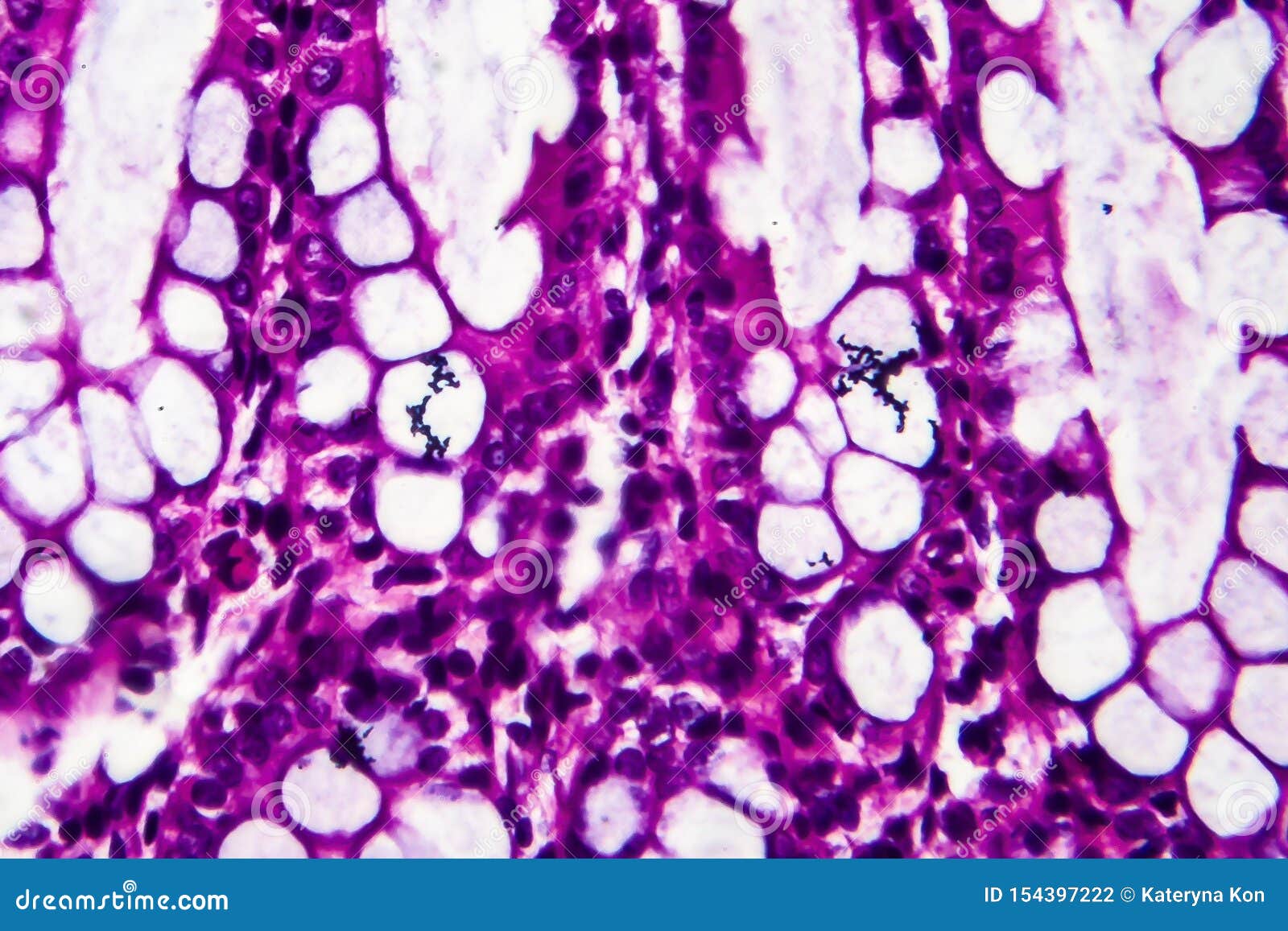 Bacillary Dysentery, Light Micrograph Stock Photo - Image of medicine ...